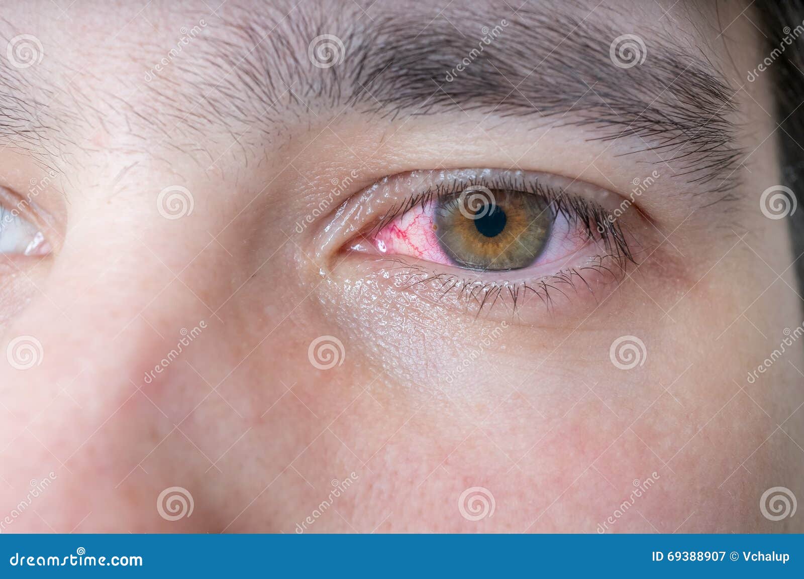 Man with red injured eye stock image. Image of blood - 69388907