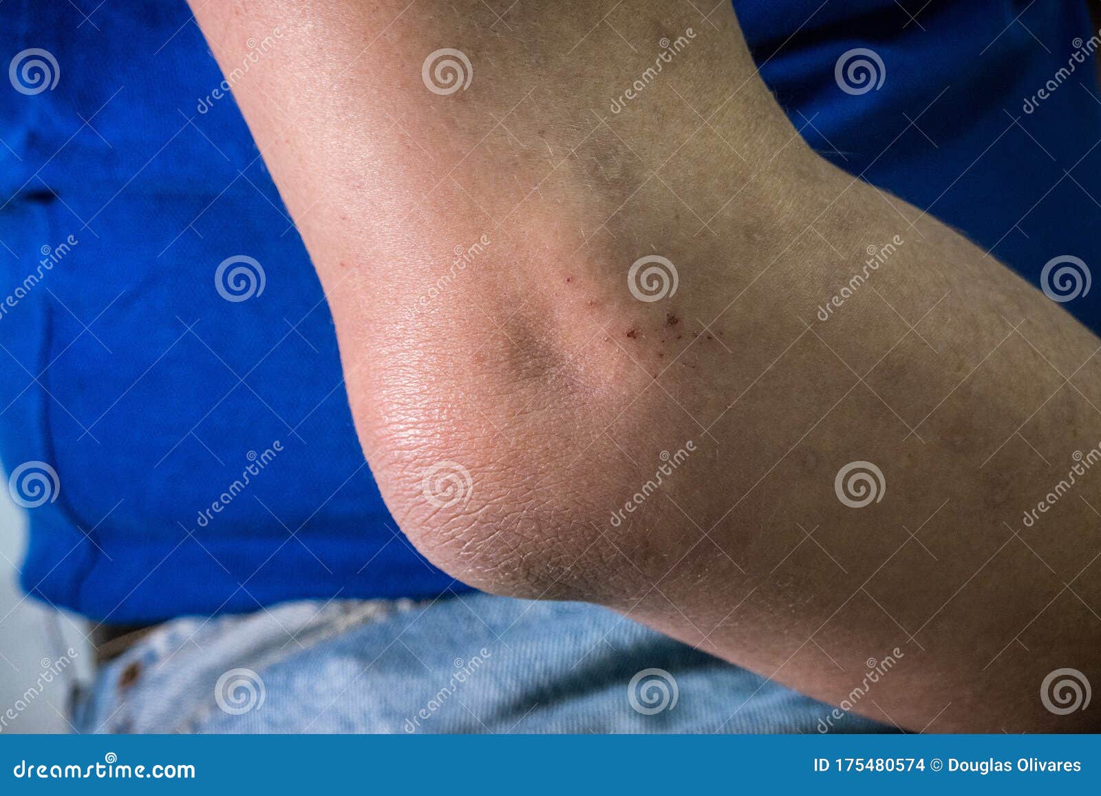 Man with Right Elbow with Cellulitis Stock Photo - Image of park ...