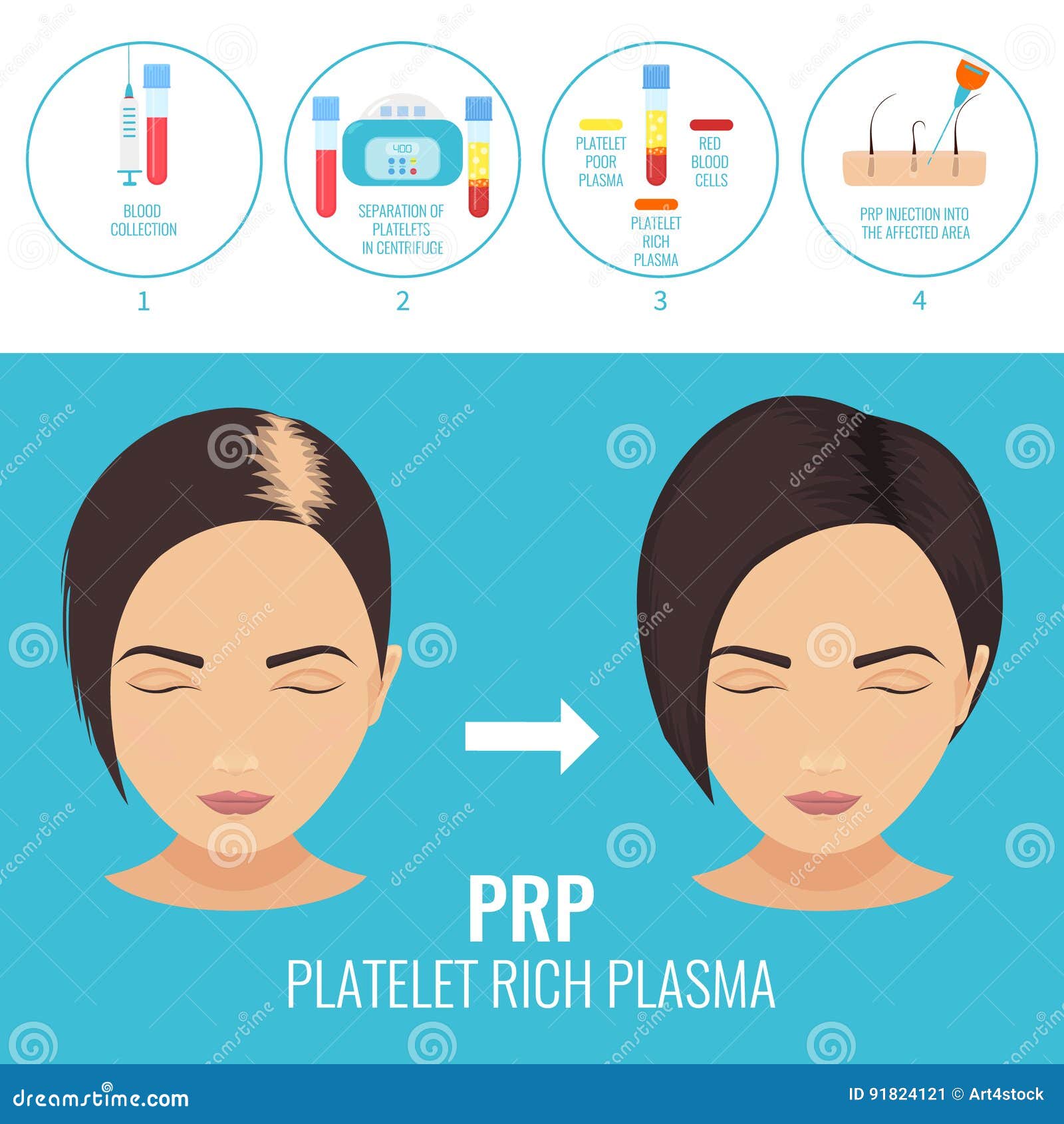 PRP Treatment For Hair Loss Stock Illustration | CartoonDealer.com ... PRP Treatment For Hair Loss Stock Illustration | CartoonDealer.com ...