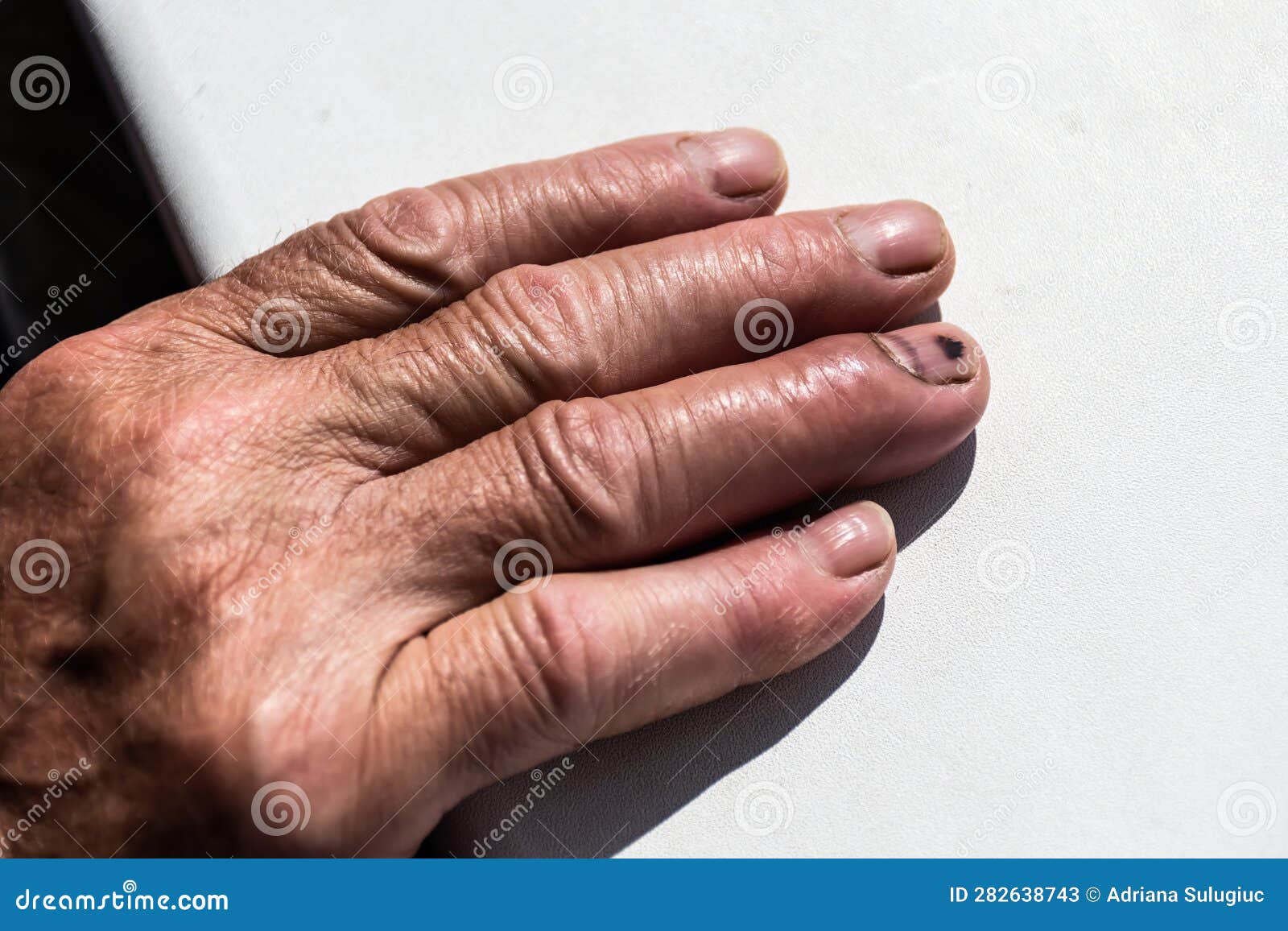 A Man S Hand with a Broken Finger Stock Image - Image of disease ...