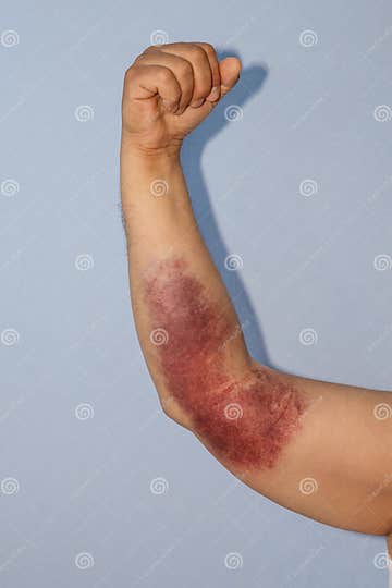Man`s hand with hematoma 1 stock image. Image of healthcare - 97170569