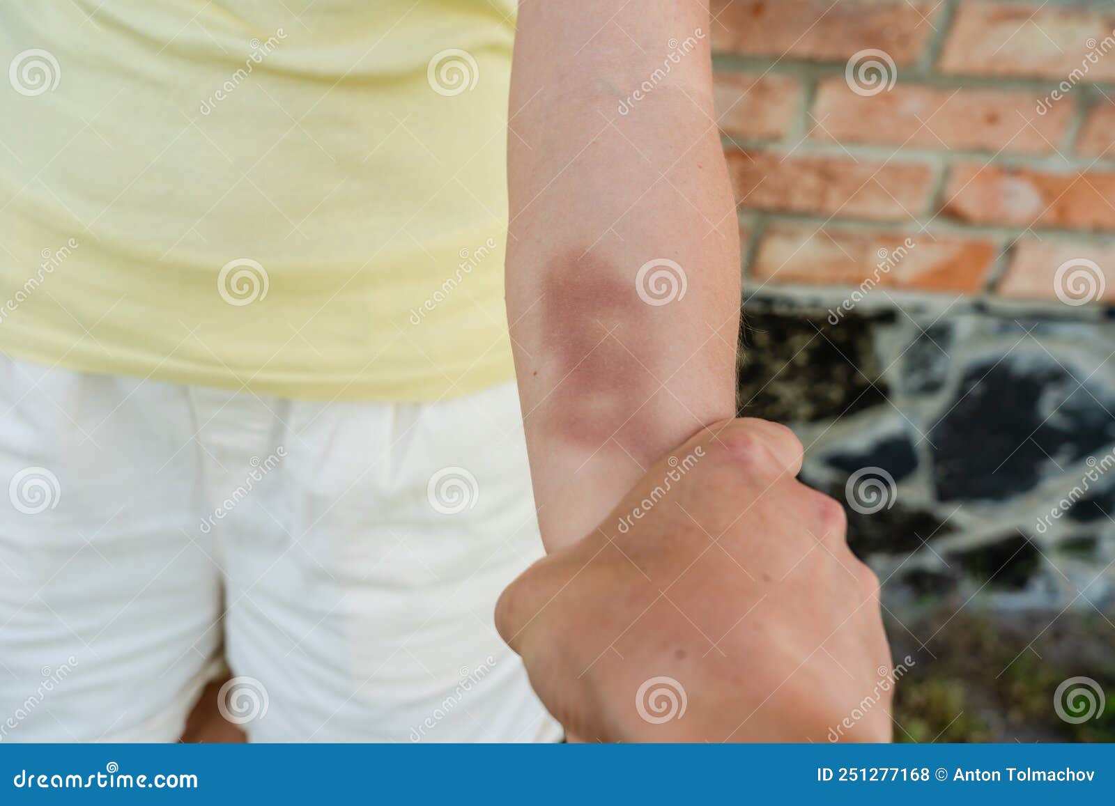 Man`s Hand Keep Woman`s Hand with Bruise. Stock Photo - Image of hard ...