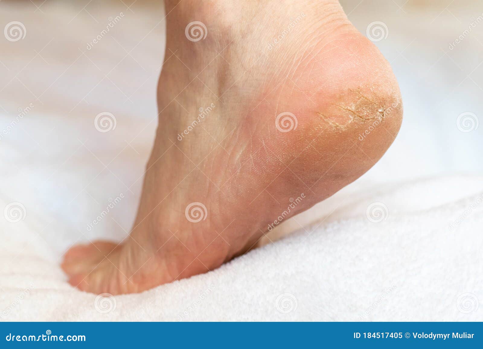 Man`s Leg with Cracks on the Heel Stock Image - Image of defect ...