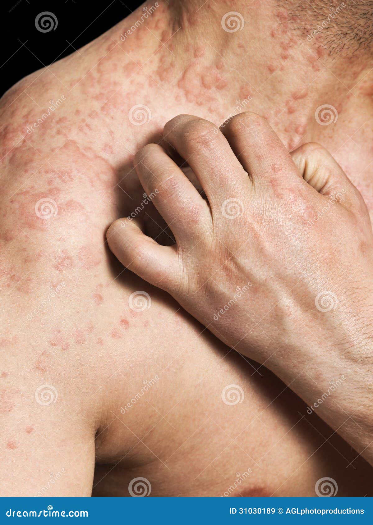 Man Scratching Allergic Skin Stock Image - Image of person, irritation ...