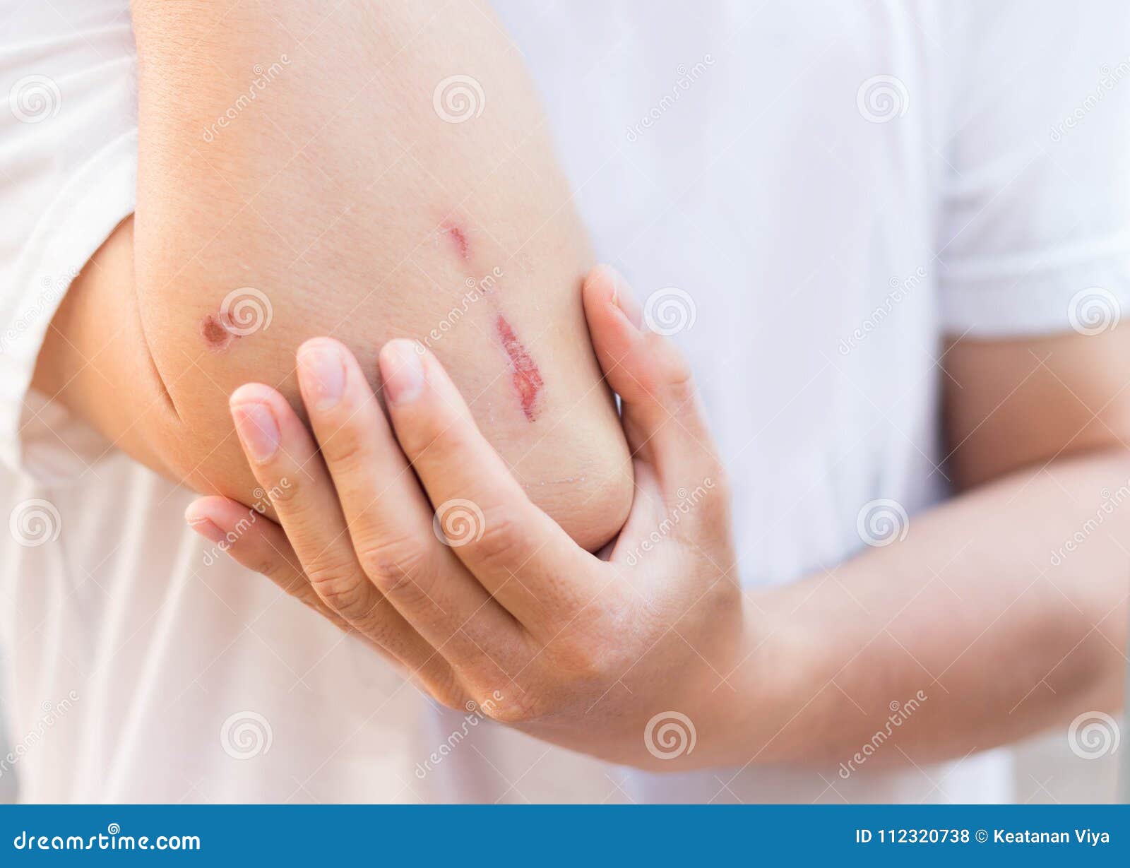 Man Show Lesion or Wound on His Arm after Accident Stock Photo - Image ...