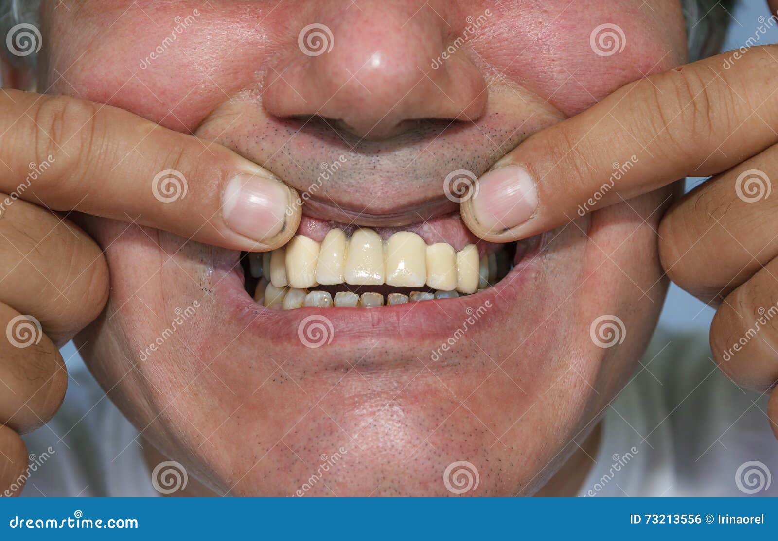 Man Showing False Front Upper Teeth Stock Photo - Image of hands, lips ...
