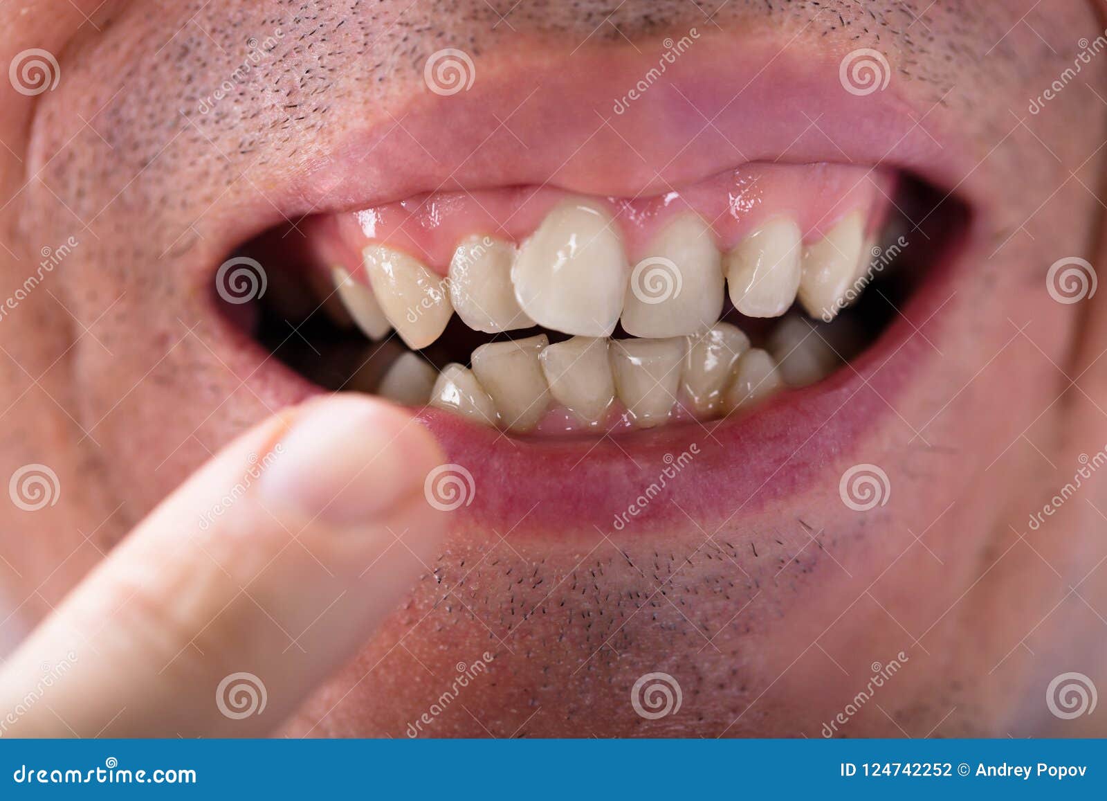 Man Showing His Teeth stock photo. Image of orthodontic - 124742252