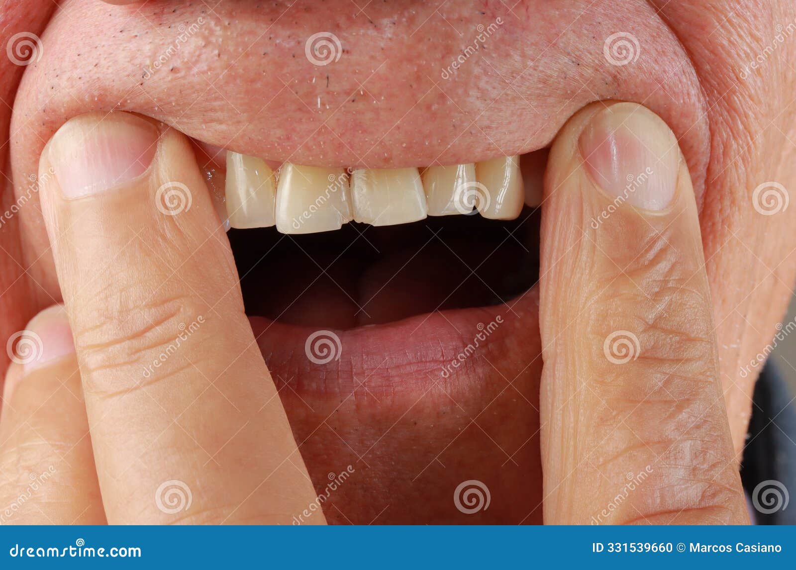 Man Showing His Two Front Incisors Teeth that are Chipped Stock Photo ...