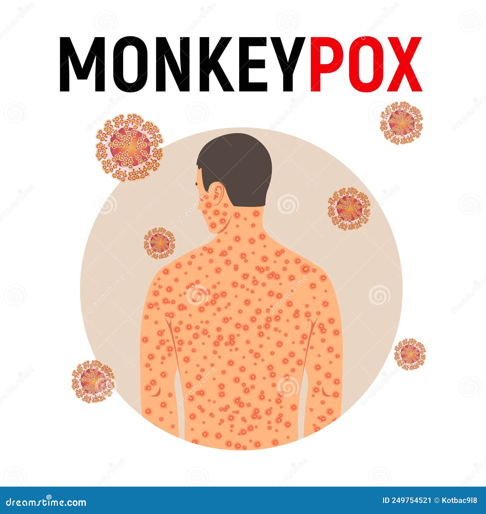 Man Sick with Monkey Smallpox in Flat Style Stock Vector - Illustration ...