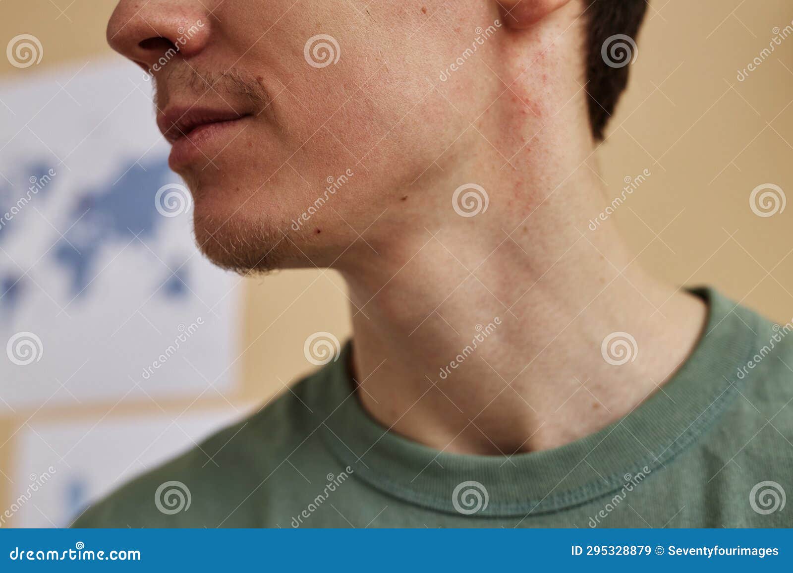 Man with Skin Rash or Psoriasis Spots on Neck Stock Image - Image of ...