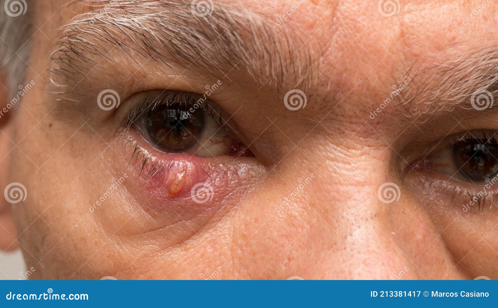 Man with stye on eyelid stock image. Image of stye, bump - 213381417