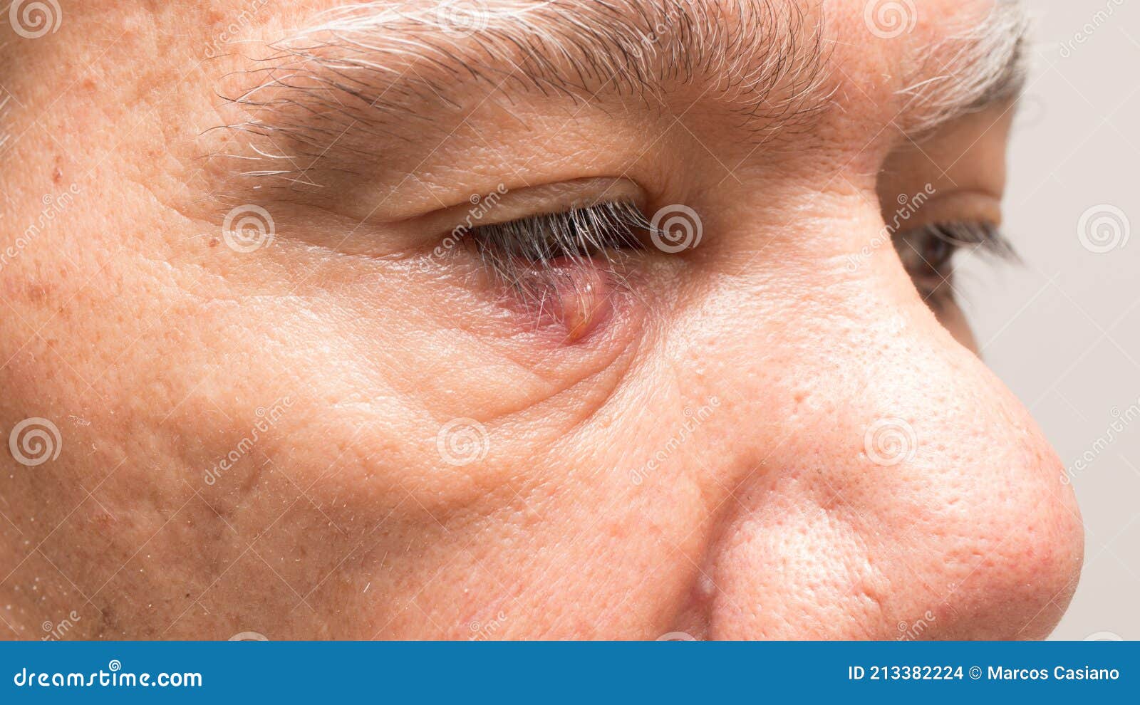 Man with stye on eyelid stock photo. Image of lumps - 213382224