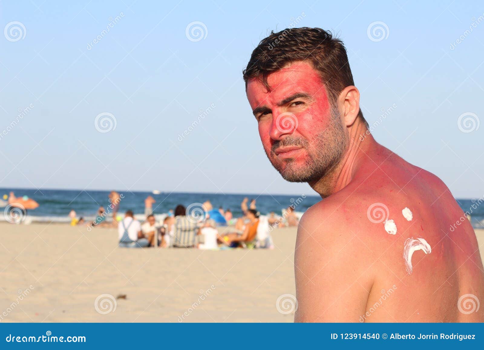 Man Suffering the Consequences of Too Much Uv Light Exposure Stock ...