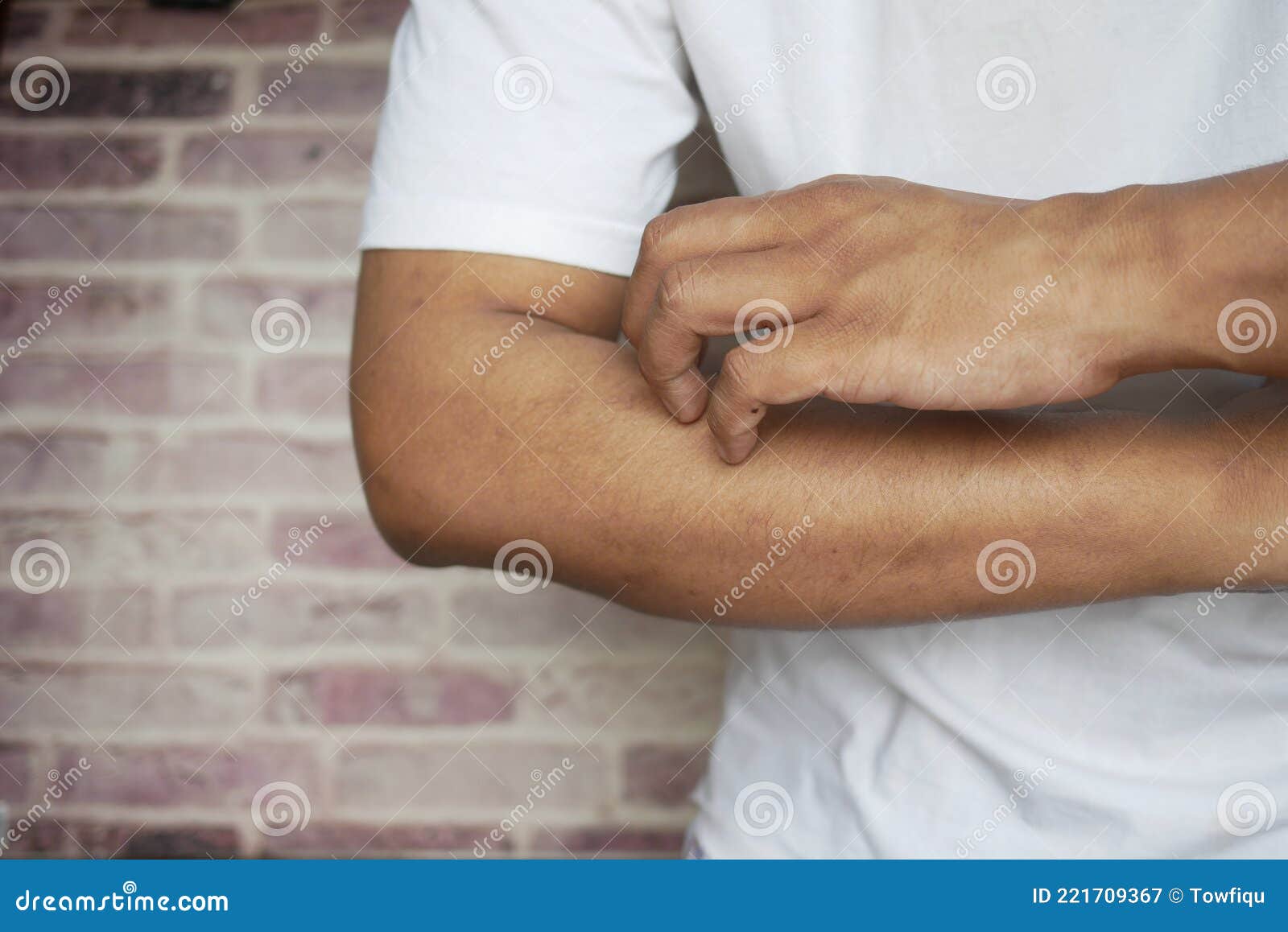Man Suffering from Itching Skin, Close Up. Stock Image - Image of white ...