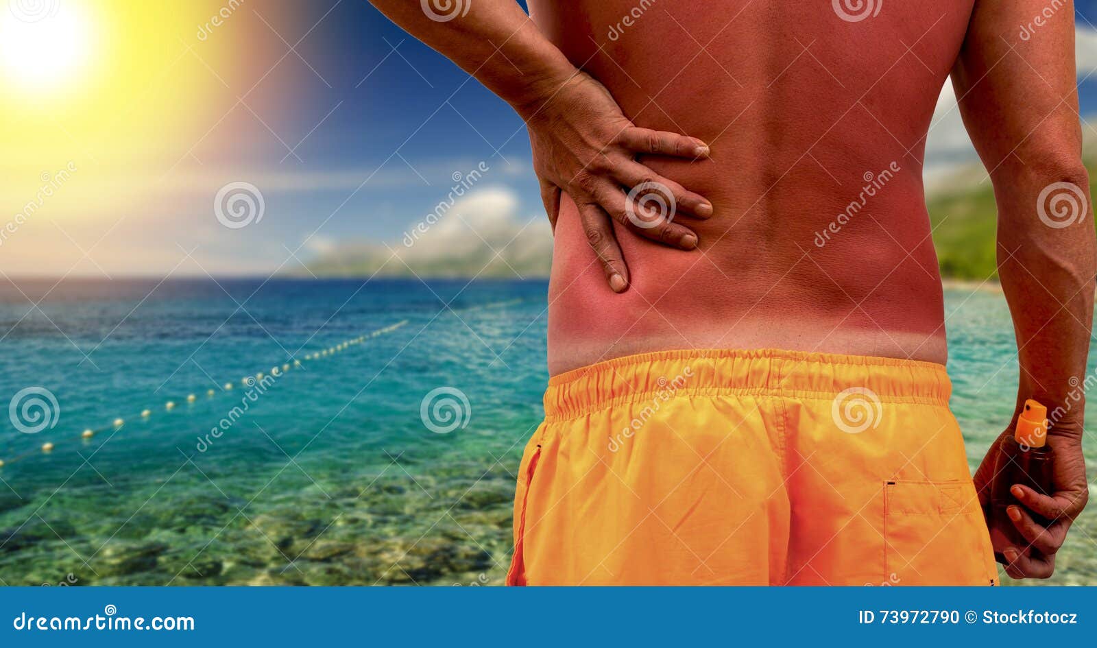Man with sunburned skin stock photo. Image of health - 73972790