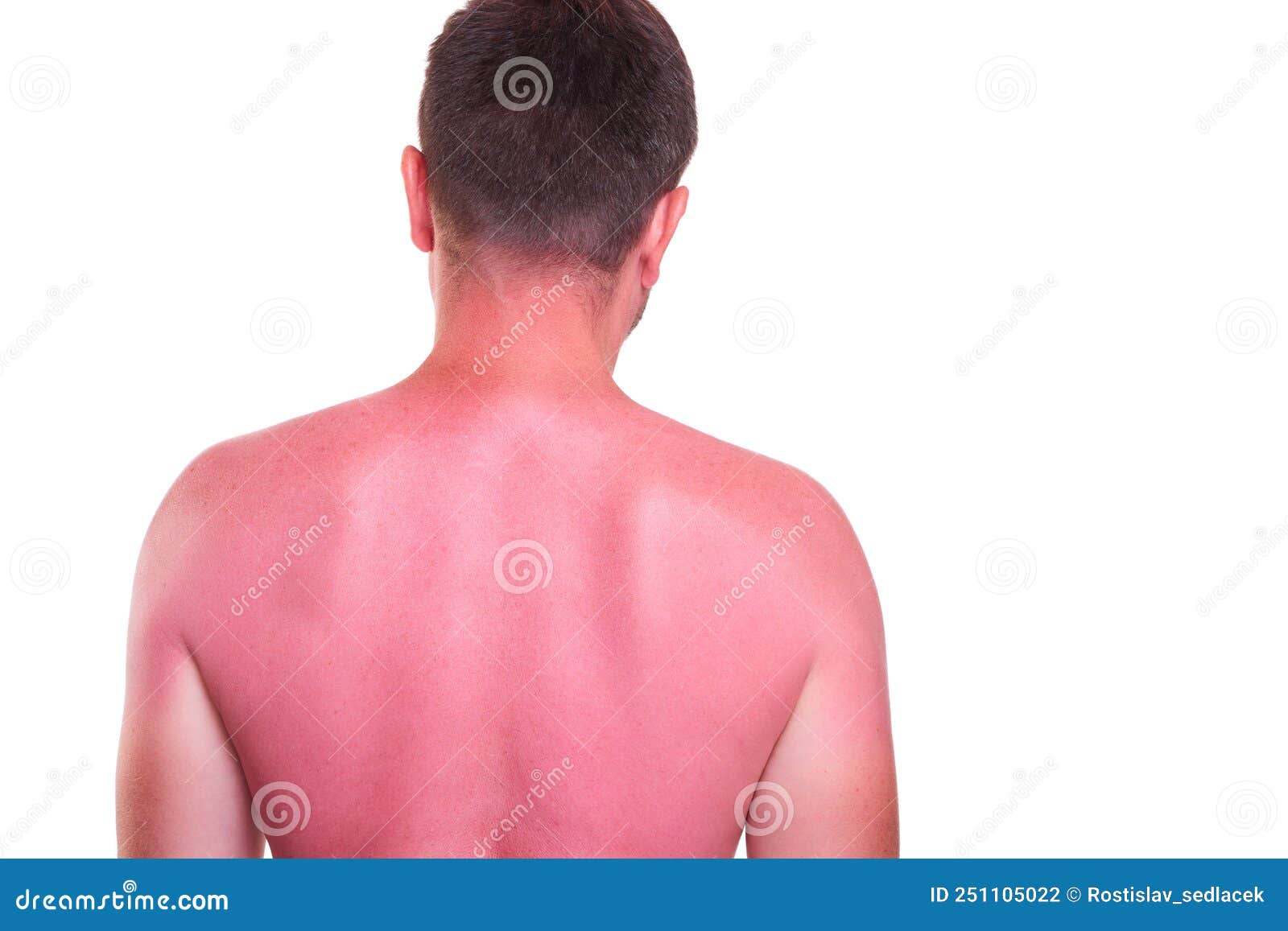 Man with Sunburnt Back on White Background Stock Photo - Image of ...