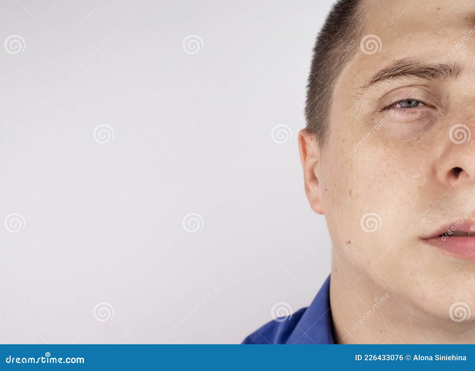 A Man with Sweating on His Face is Looking at the Camera. Sweat Gland ...