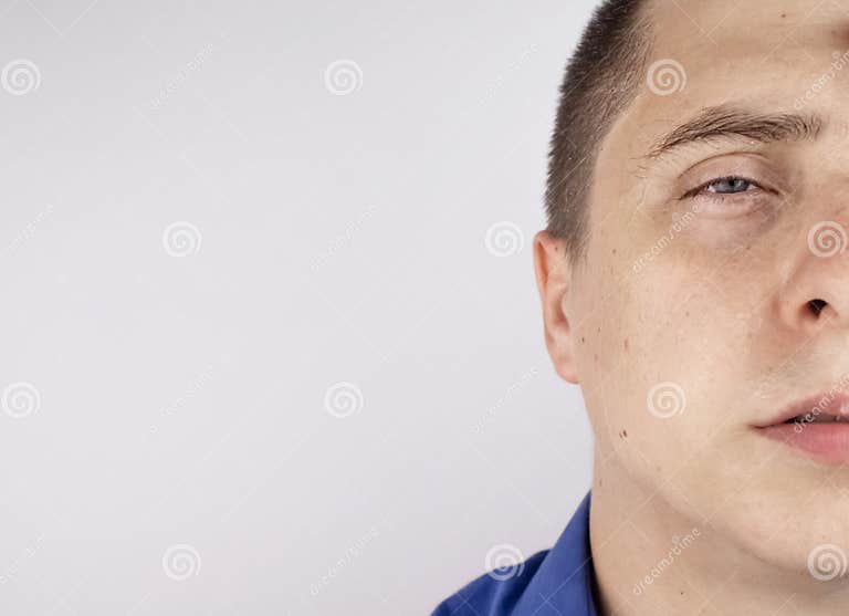 A Man with Sweating on His Face is Looking at the Camera. Sweat Gland ...