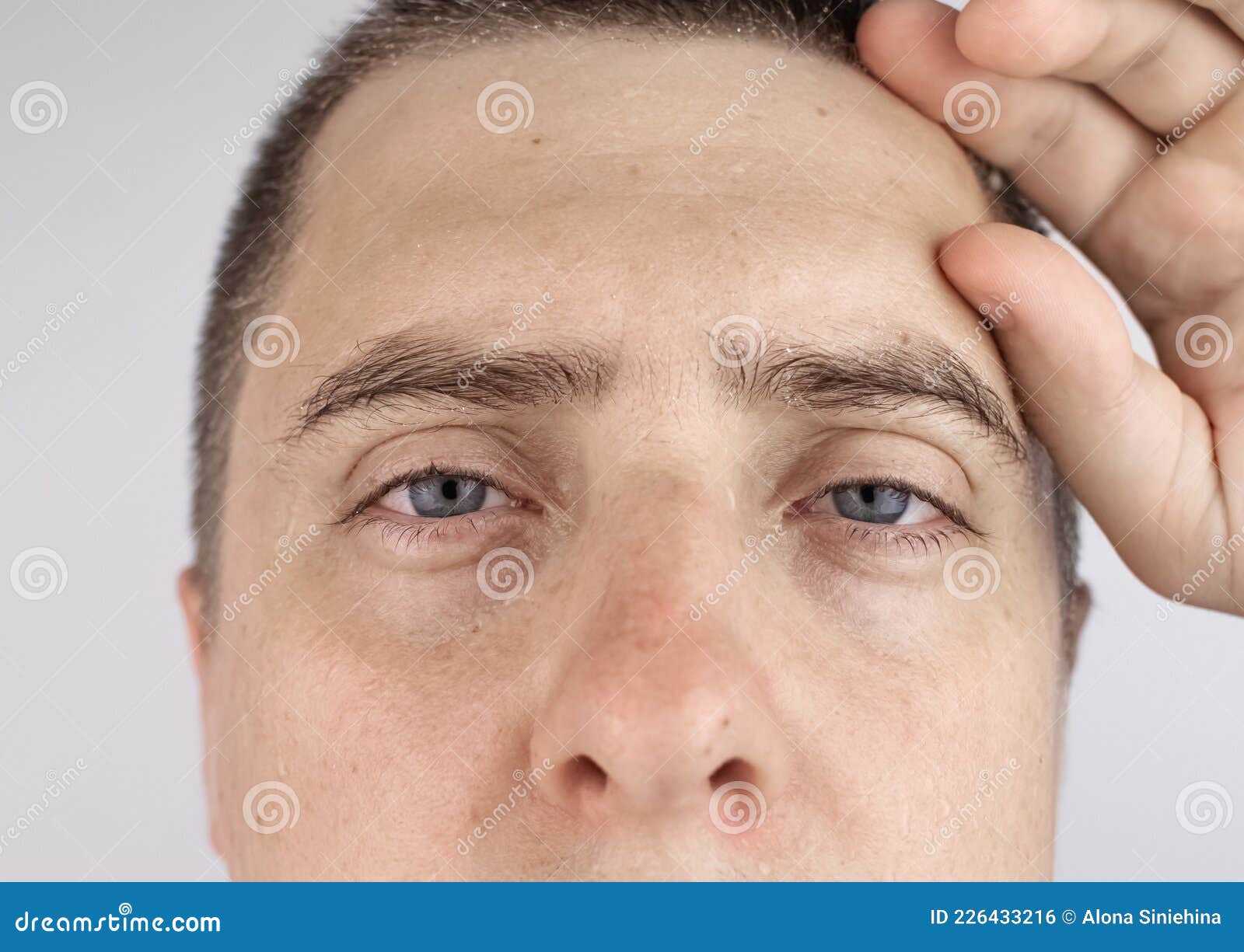 A Man with Sweating on His Face is Looking at the Camera. Sweat Gland ...