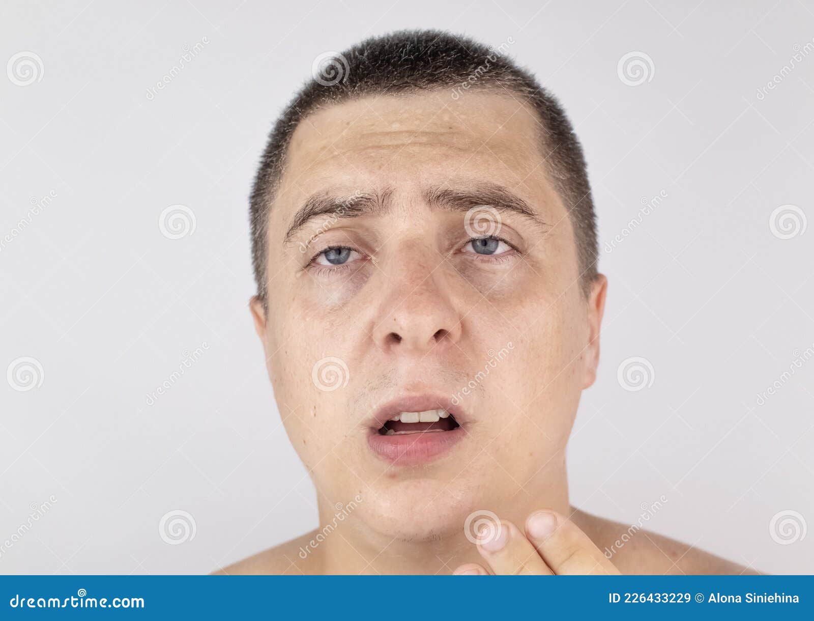 A Man with Sweating on His Face is Looking at the Camera. Sweat Gland ...