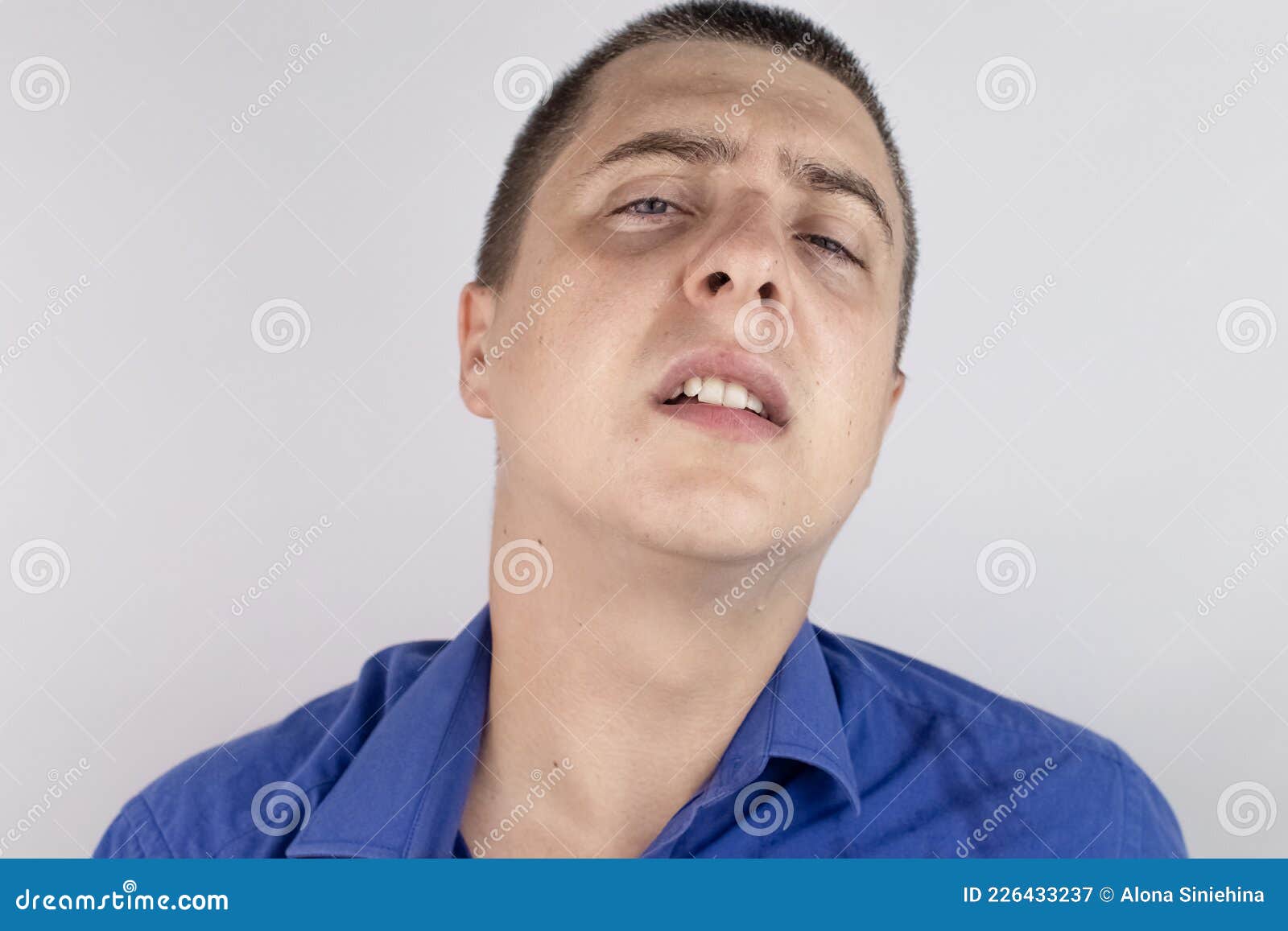 A Man with Sweating on His Face is Looking at the Camera. Sweat Gland ...