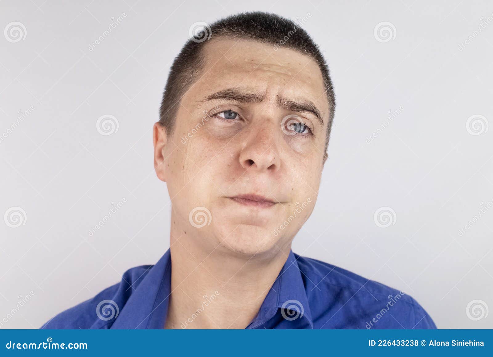 A Man with Sweating on His Face is Looking at the Camera. Sweat Gland ...