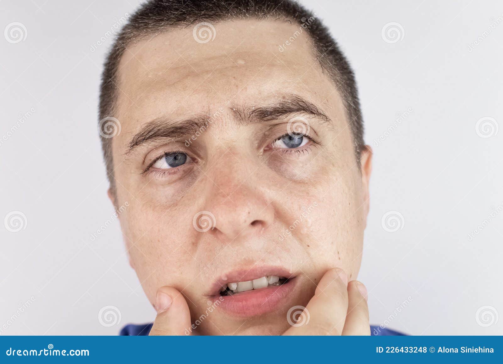 A Man with Sweating on His Face is Looking at the Camera. Sweat Gland ...
