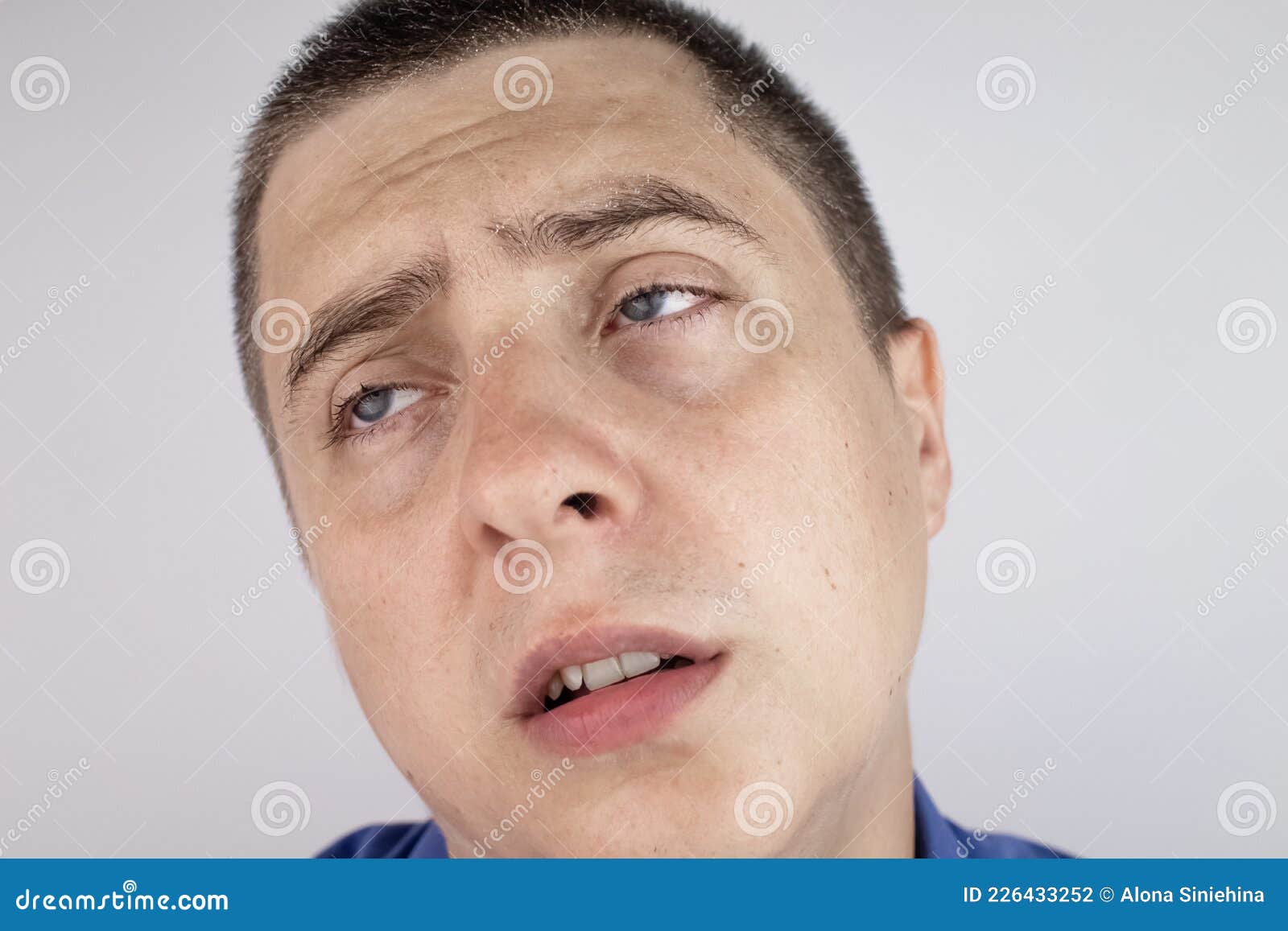 A Man with Sweating on His Face is Looking at the Camera. Sweat Gland ...