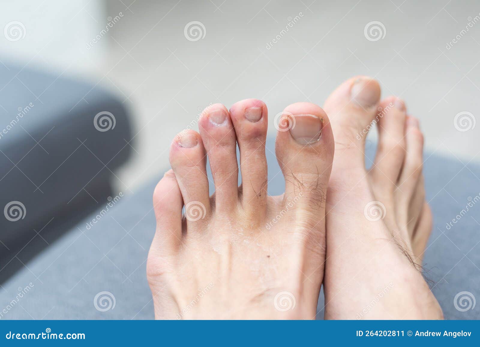 Man Toes with Hair and Dirty Toenails. Stock Image - Image of finger ...