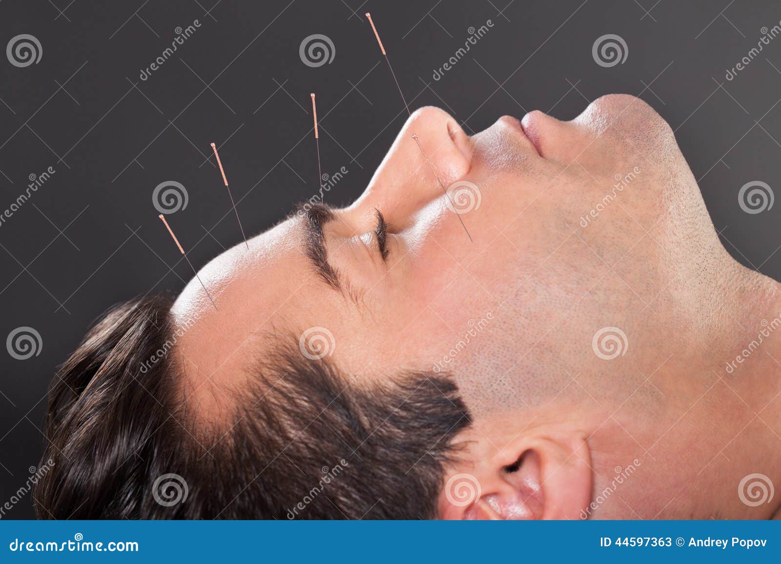 Man Undergoing Acupuncture Treatment Stock Image - Image of face, eyes ...