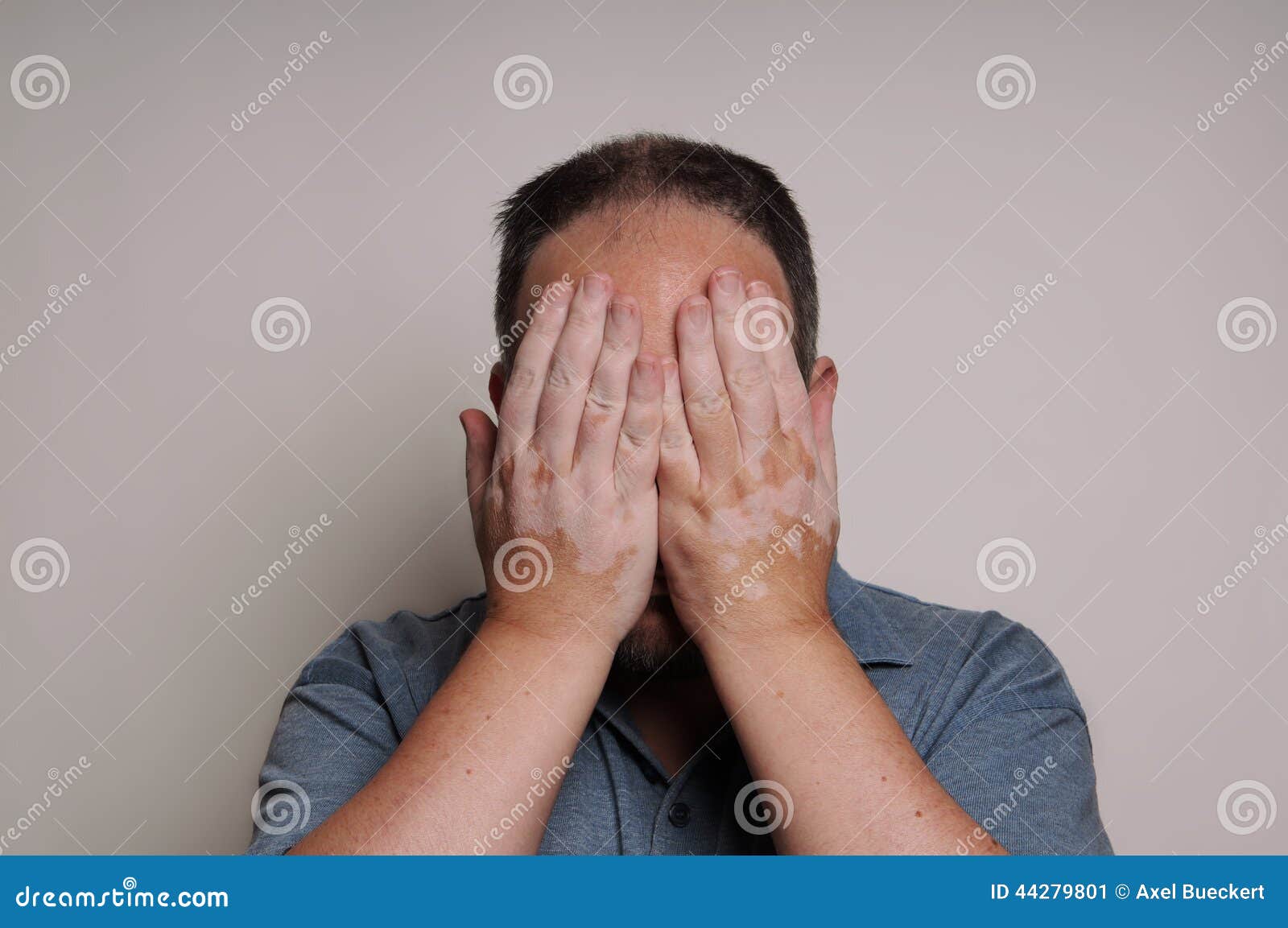 Man with Vitiligo Hiding Face Stock Image - Image of chronic, hide ...