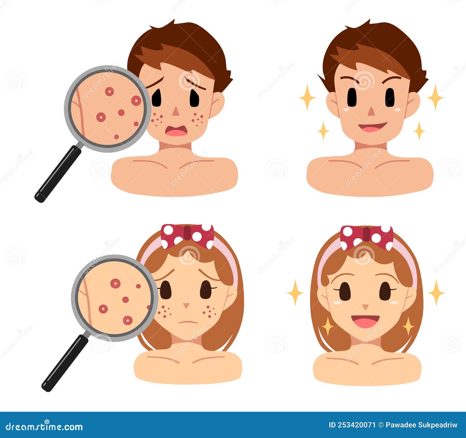 Acne Development Stages. Inflamed Skin Pimples. Plugged Hair Follicles ...