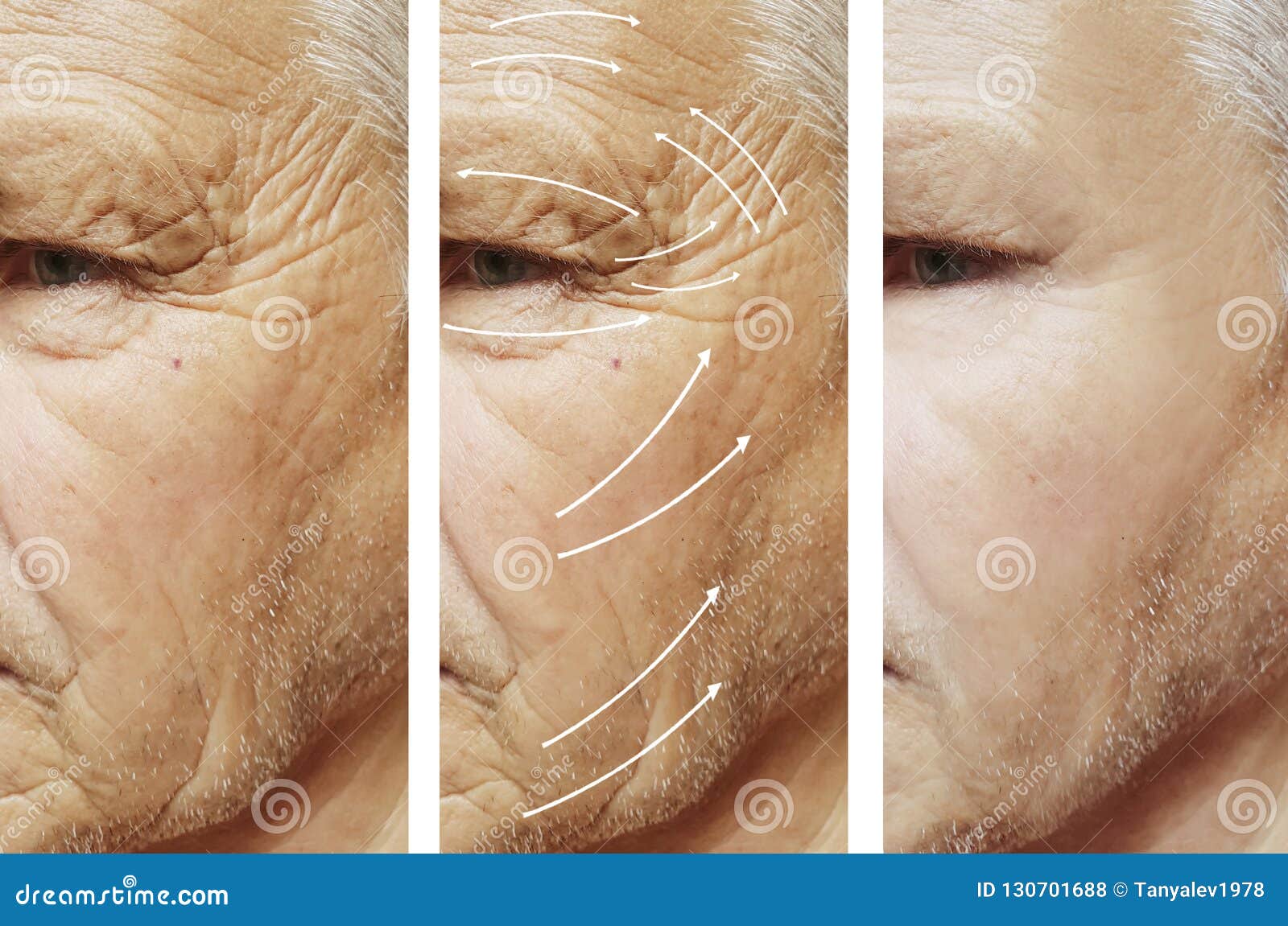 Man, Wrinkles on Face, Correction Cosmetology Difference Patient before ...
