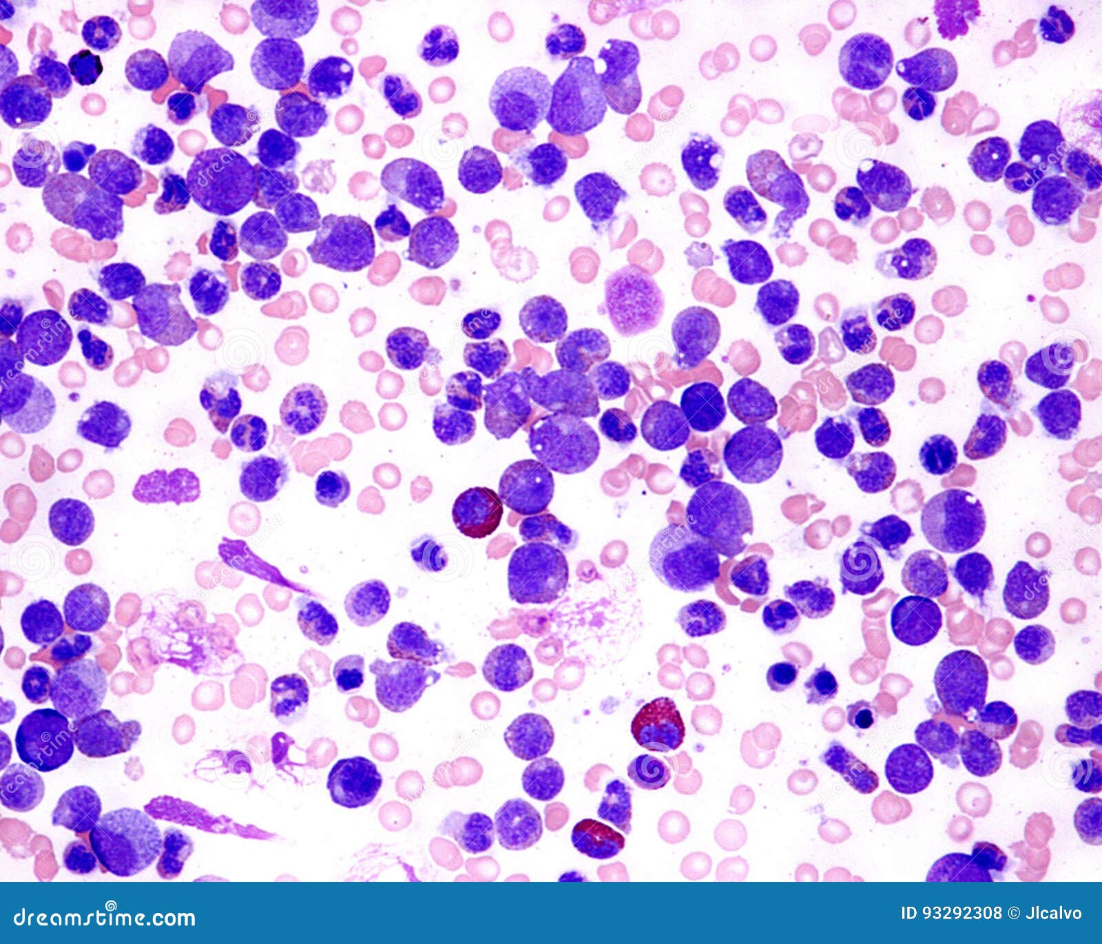 Mancha do sangue leukemia foto de stock. Imagem de histologia - 93292308