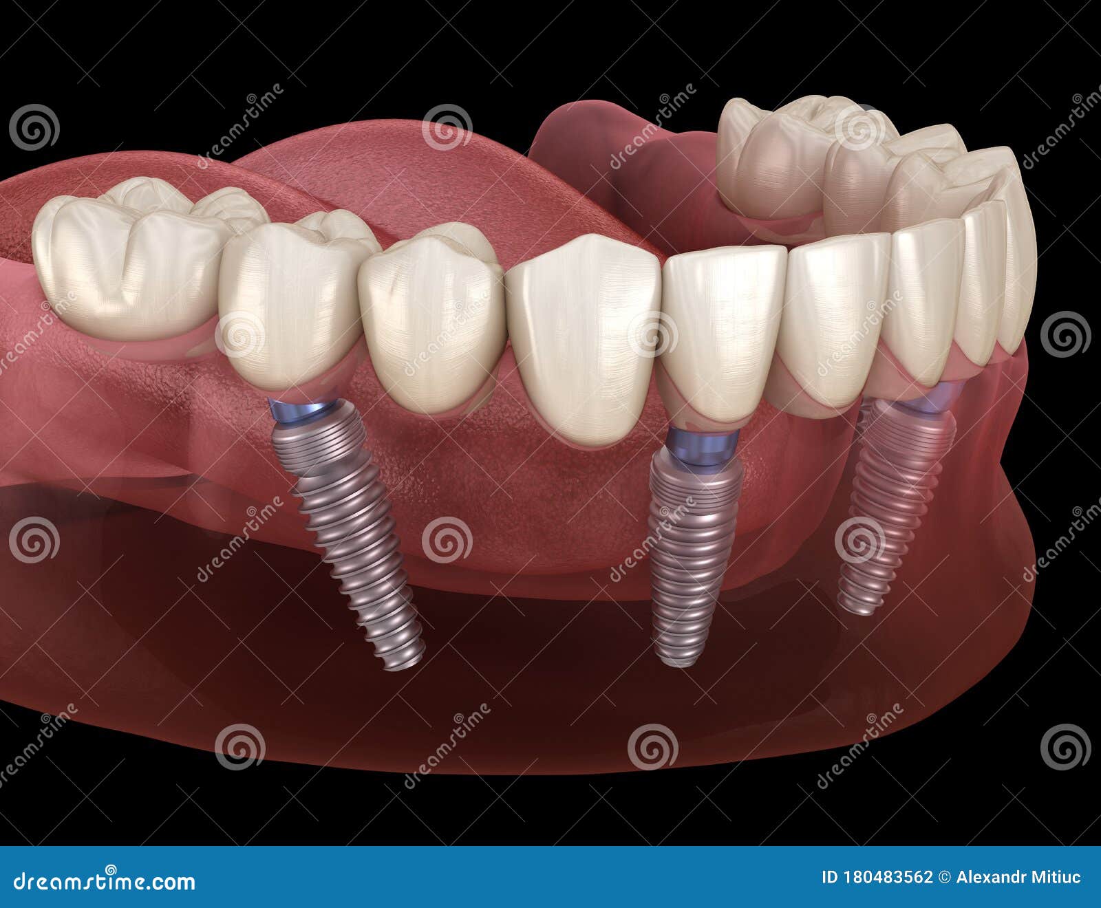 Mandibular Prosthesis All on 4 System Supported by Implants. Medically ...