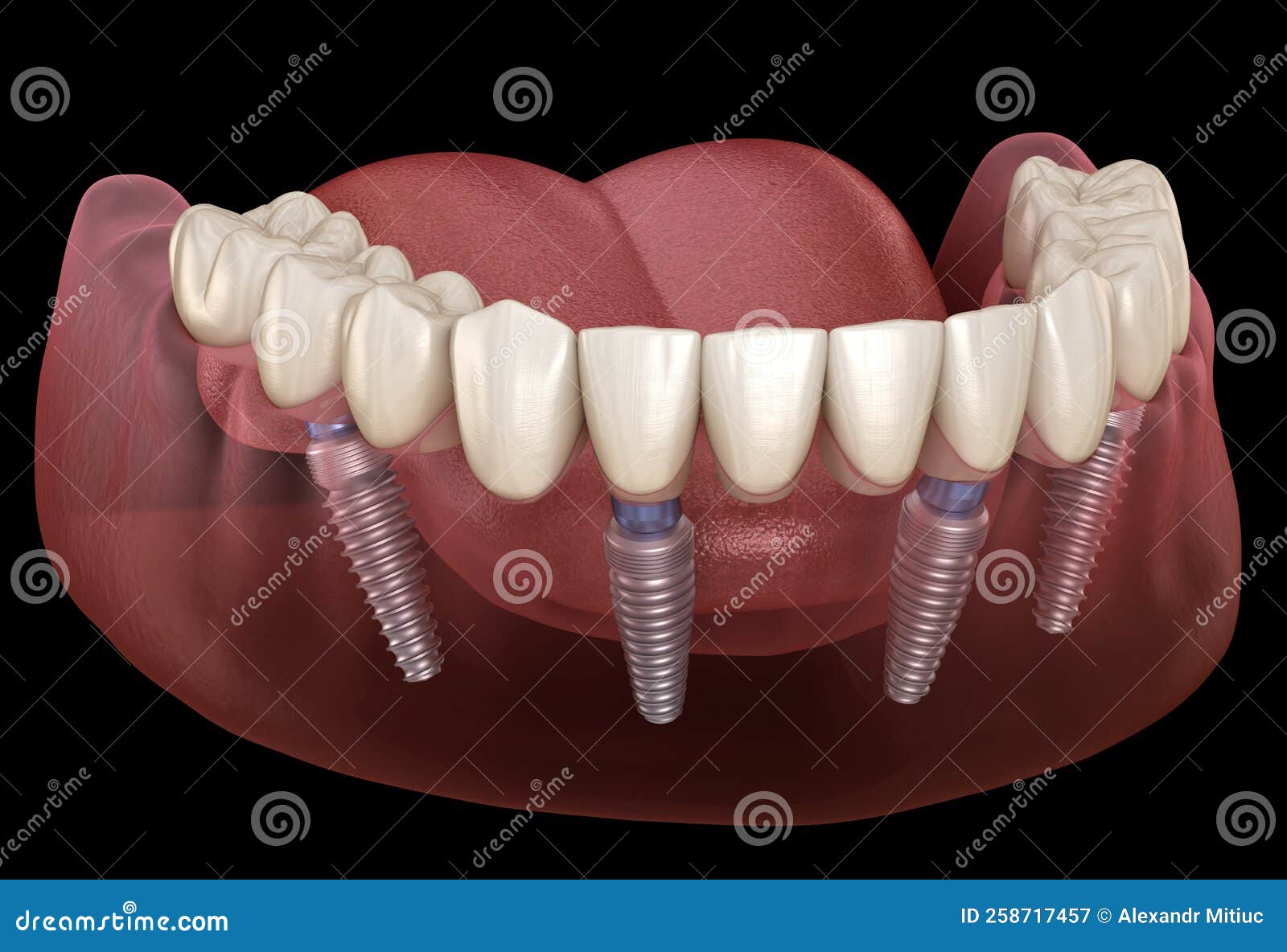 Mandibular Prosthesis All on 4 System Supported by Implants. Medically ...