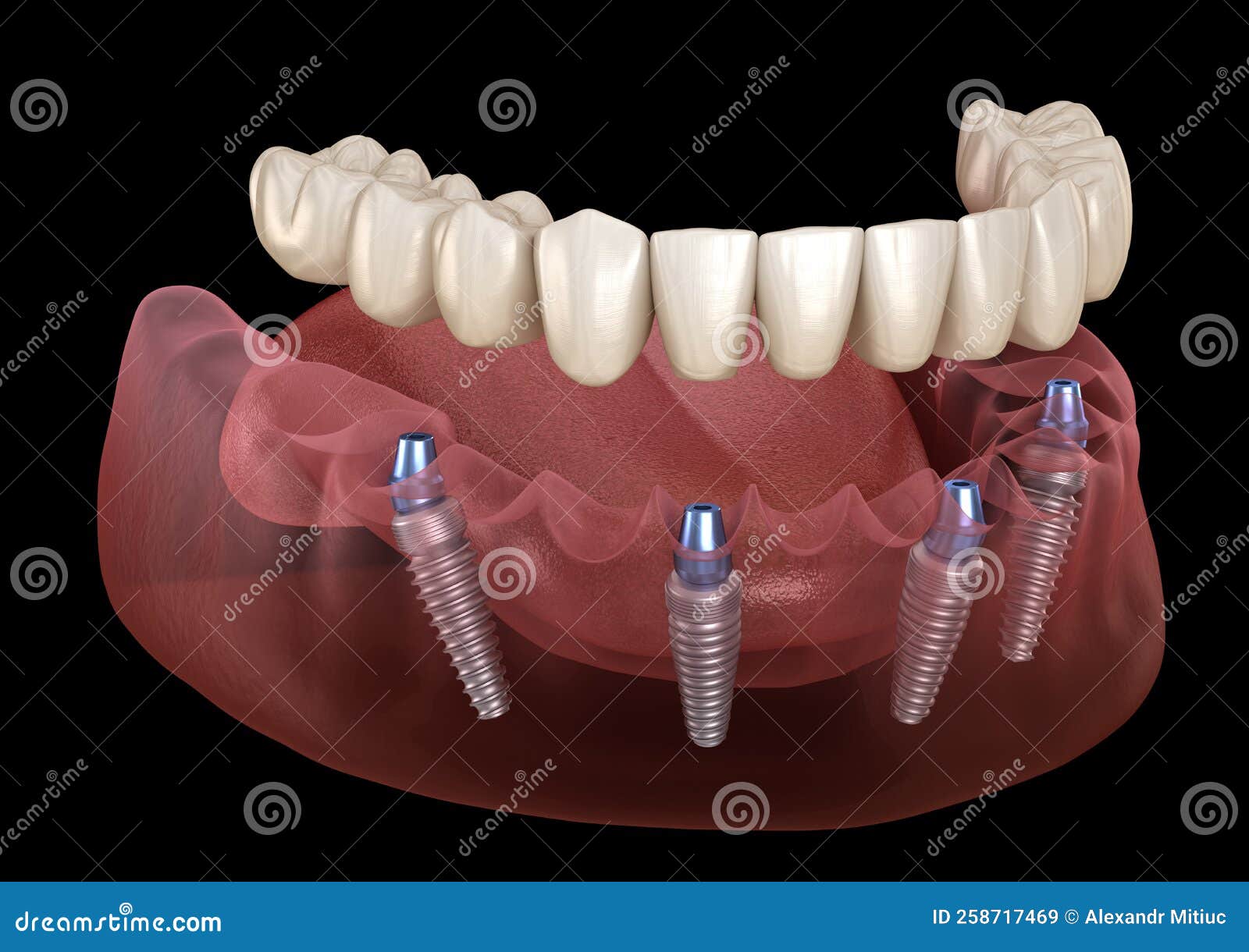 Mandibular Prosthesis All on 4 System Supported by Implants. Medically ...