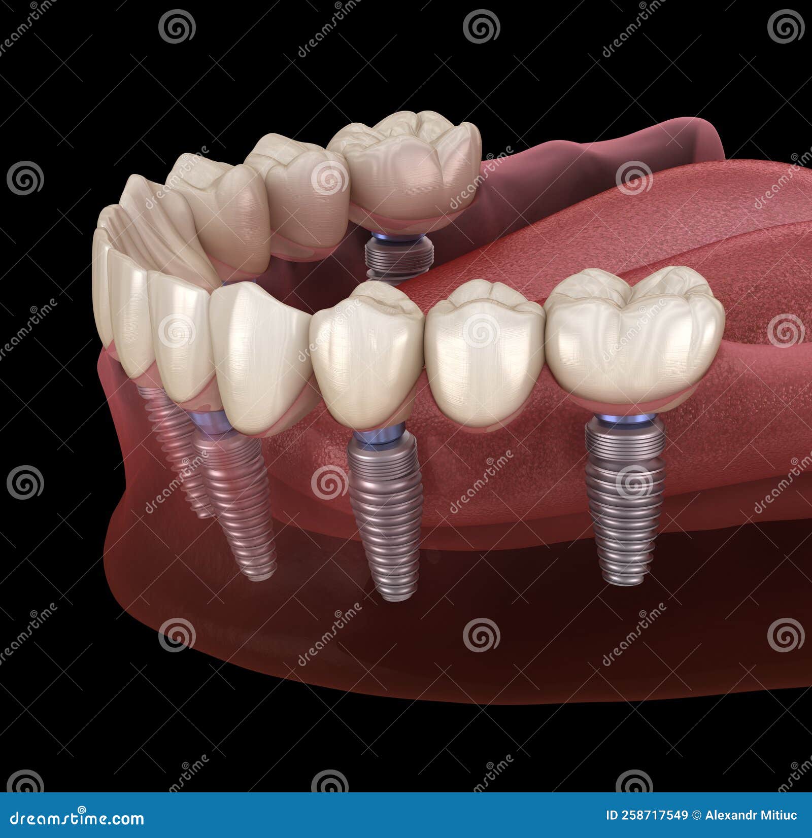 Mandibular Prosthesis All on 6 System Supported by Implants. Medically ...