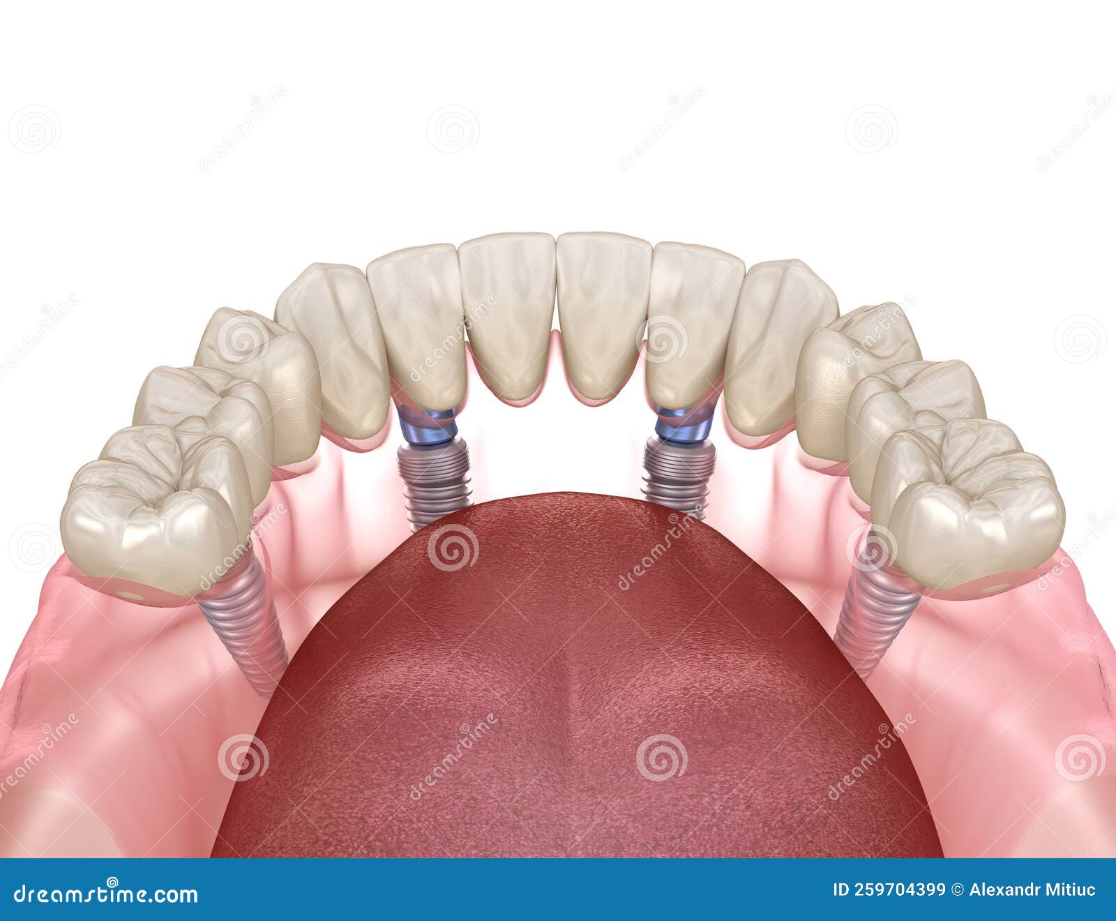 Mandibular Prosthesis All on 4 System Supported by Implants. Medically ...