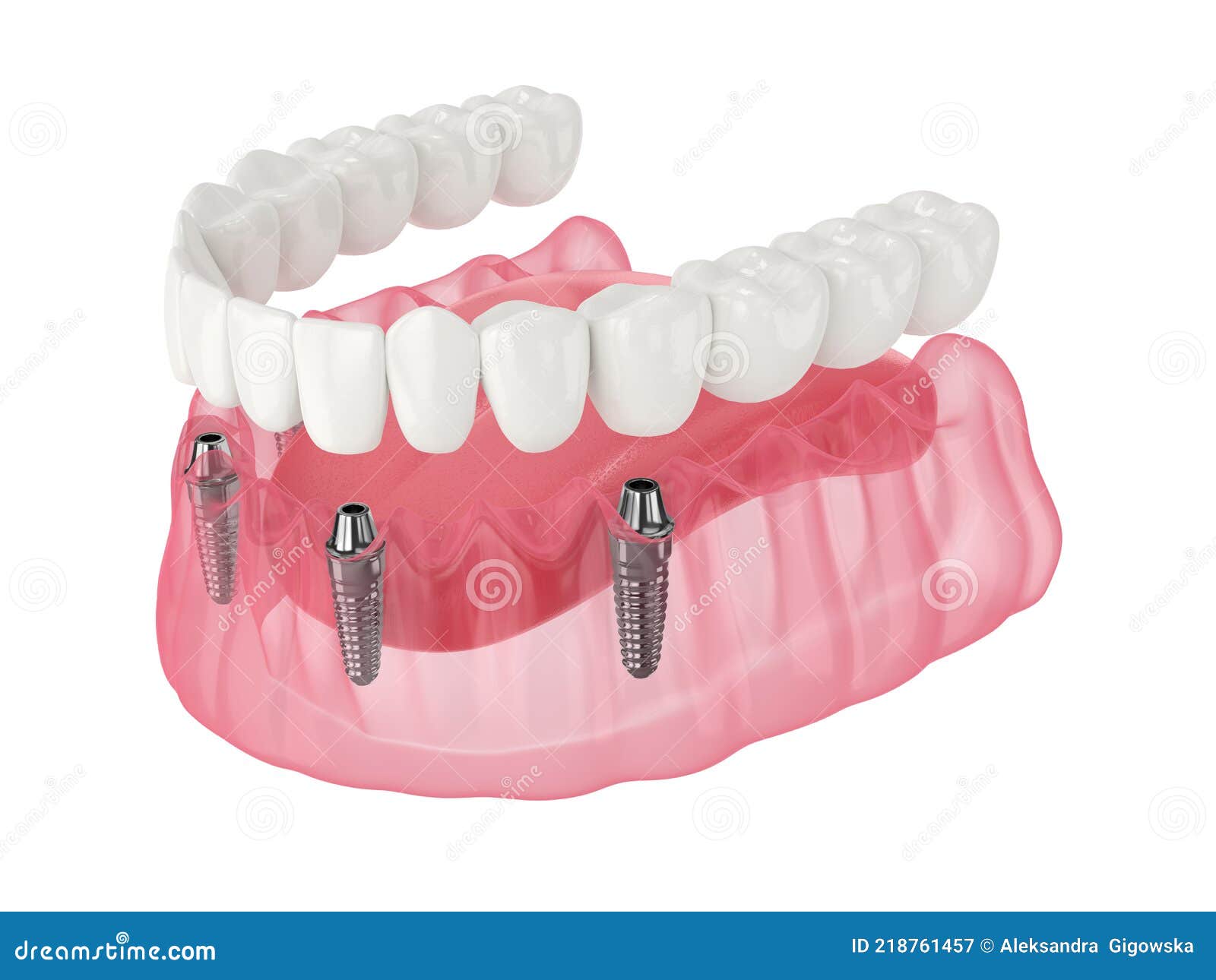 Mandibular Prosthesis All on 4 System Supported by Implants Stock ...