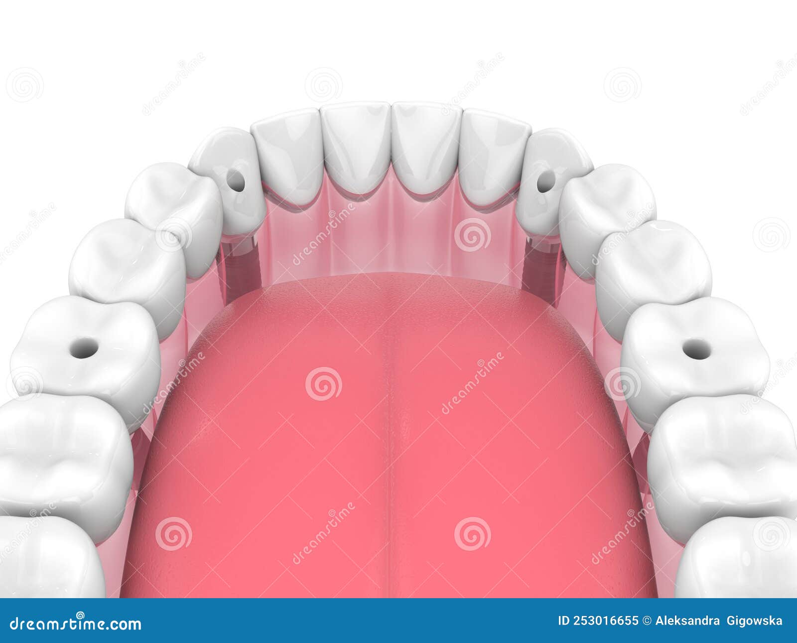 Mandibular Prosthesis All on 4 System Supported by Implants Stock ...