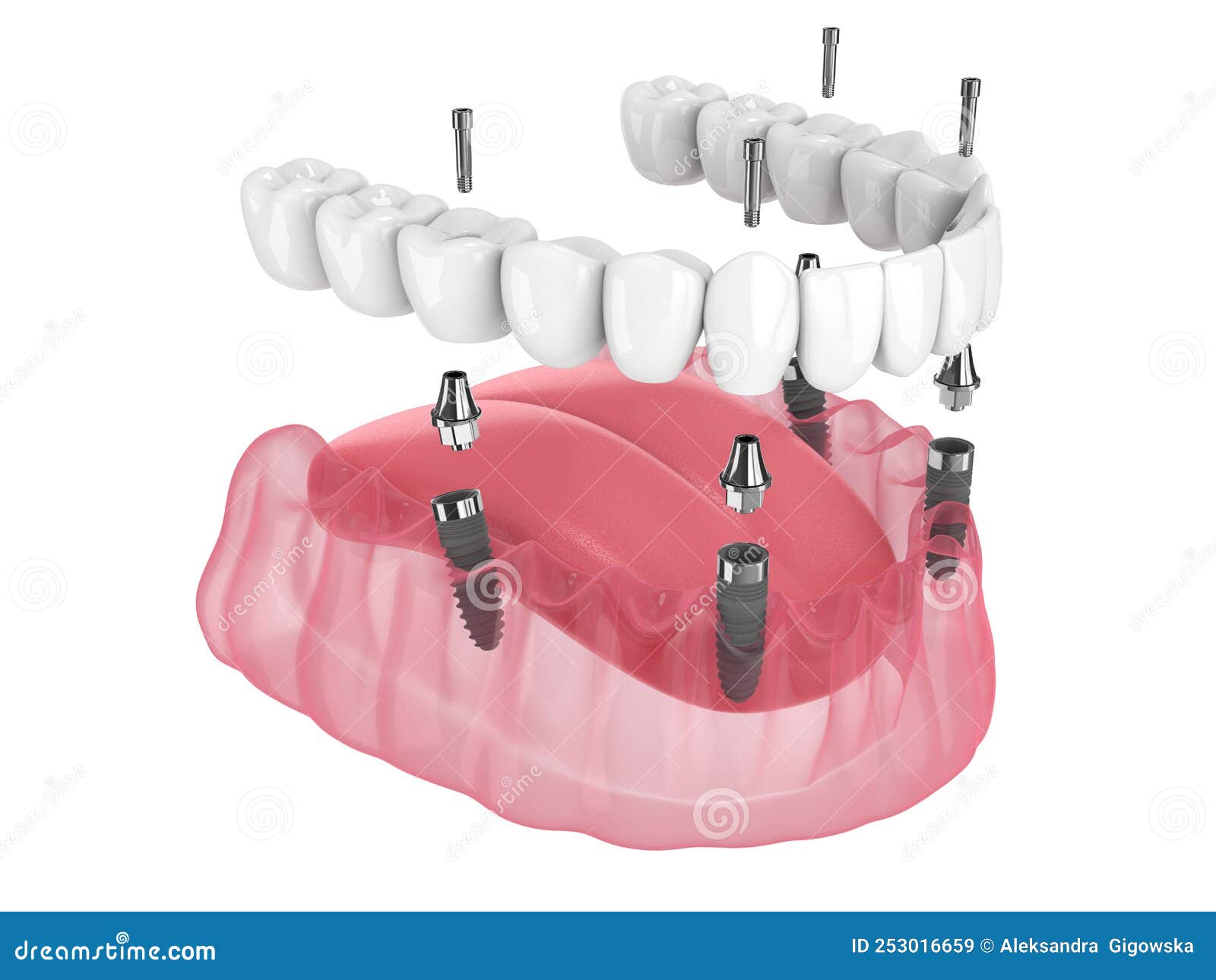 Mandibular Prosthesis All on 4 System Supported by Implants Stock ...