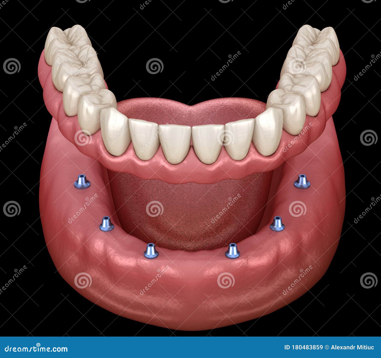 Mandibular Prosthesis with Gum All on 6 System Supported by Implants ...