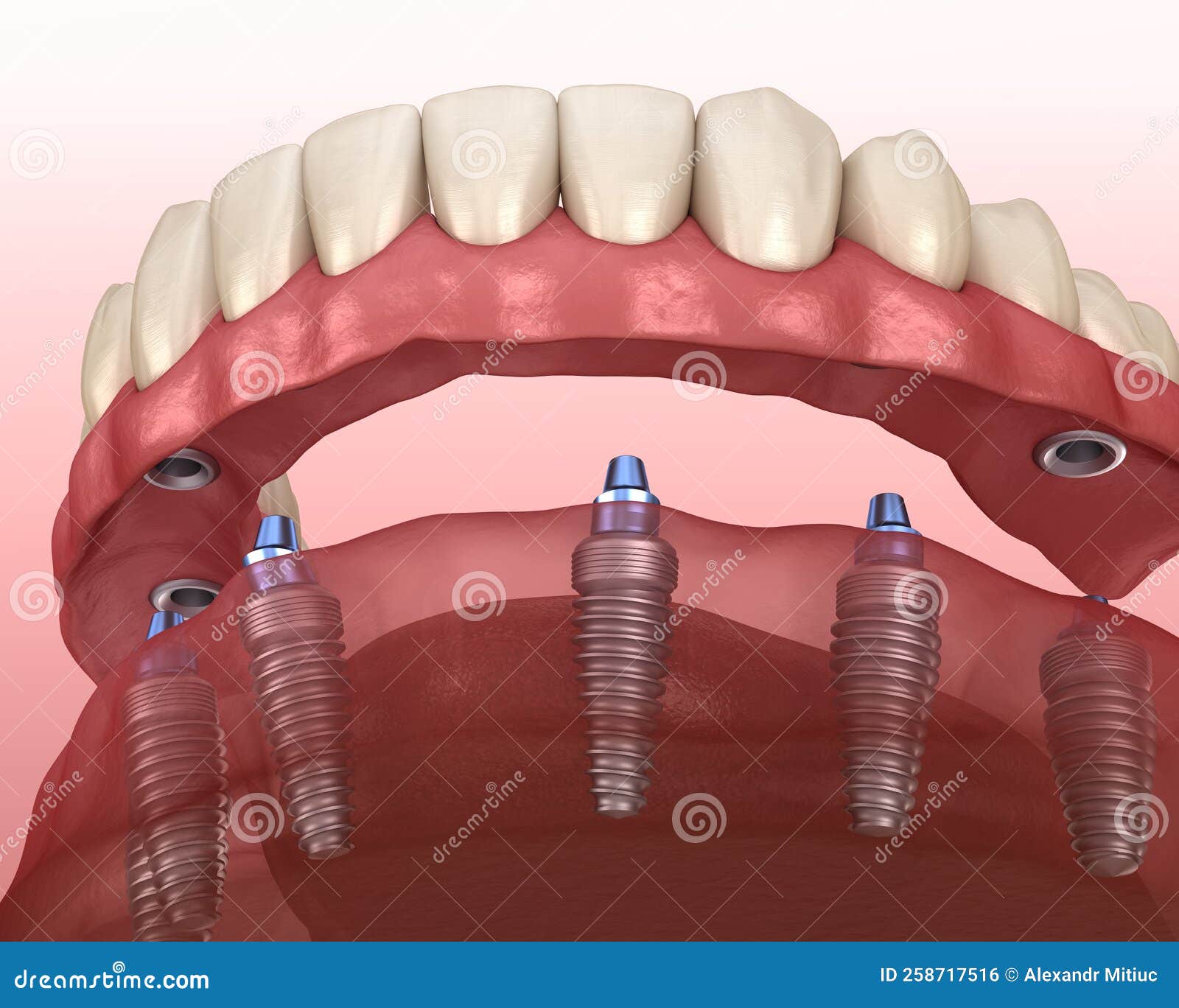 Mandibular Prosthesis with Gum All on 6 System Supported by Implants ...