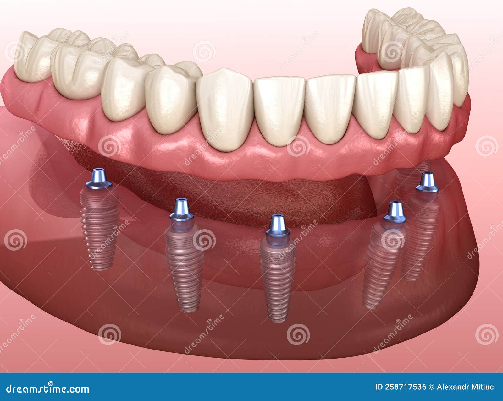 Mandibular Prosthesis with Gum All on 6 System Supported by Implants ...