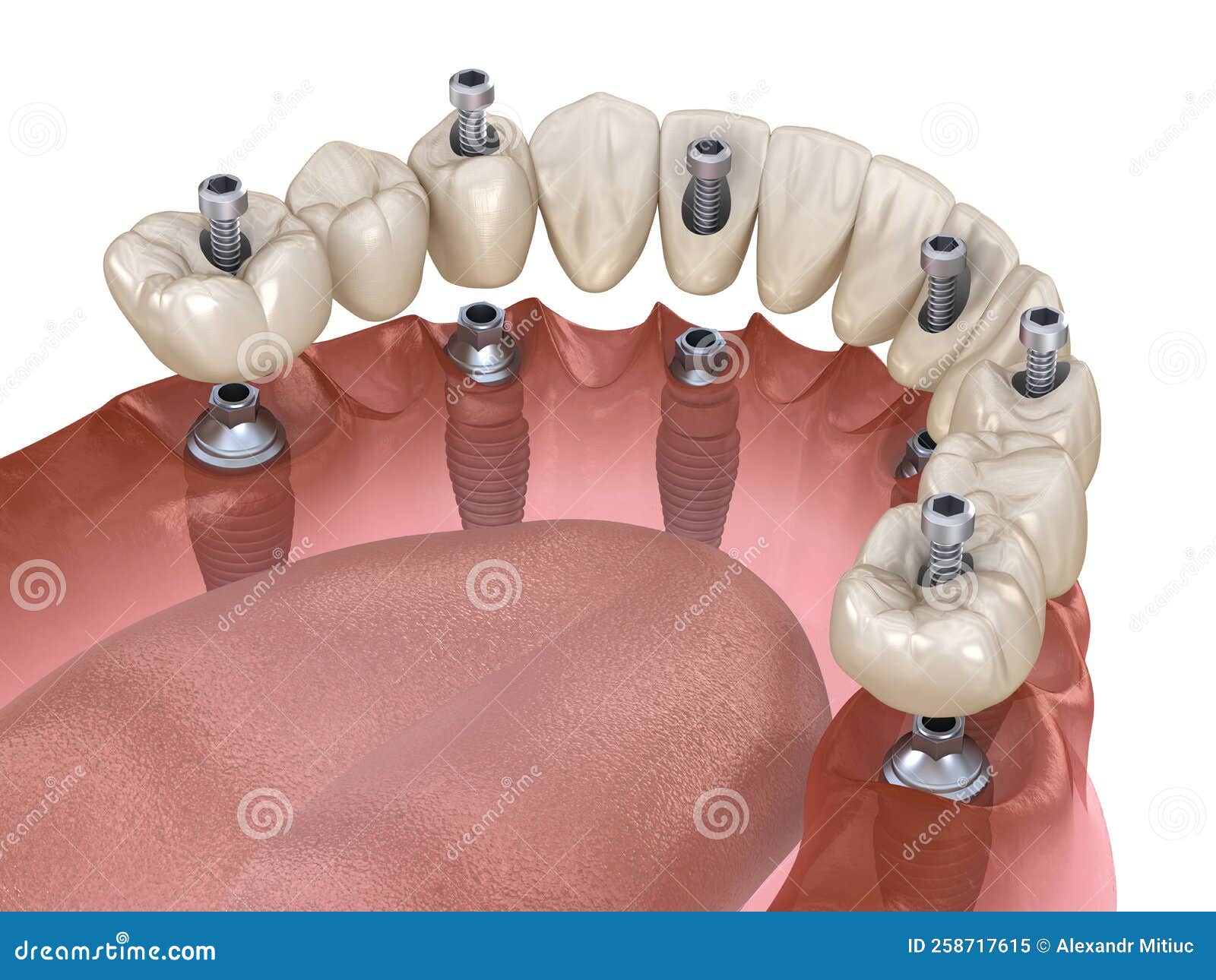 Mandibular Prosthesis with Gum All on 6 System Supported by Implants ...