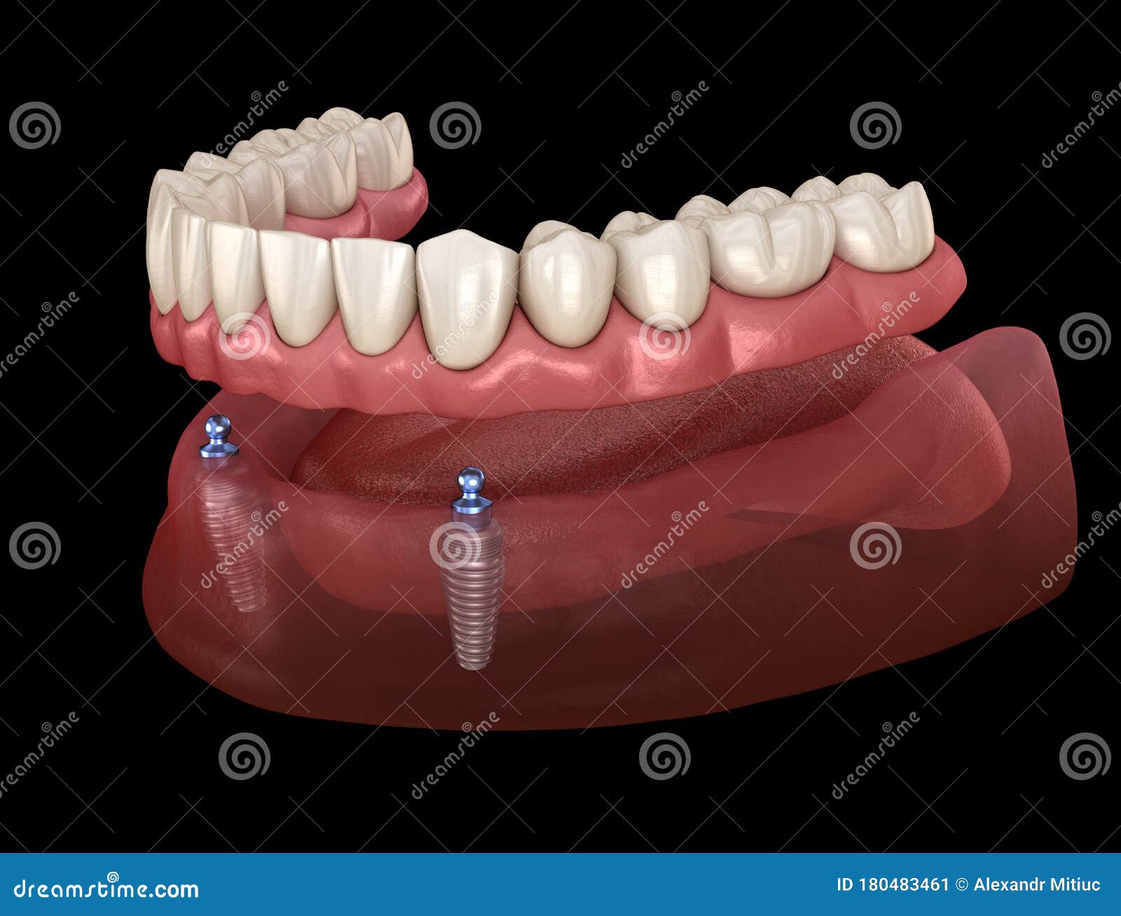 Mandibular Removable Prosthesis All on 2 System Supported by Implants ...