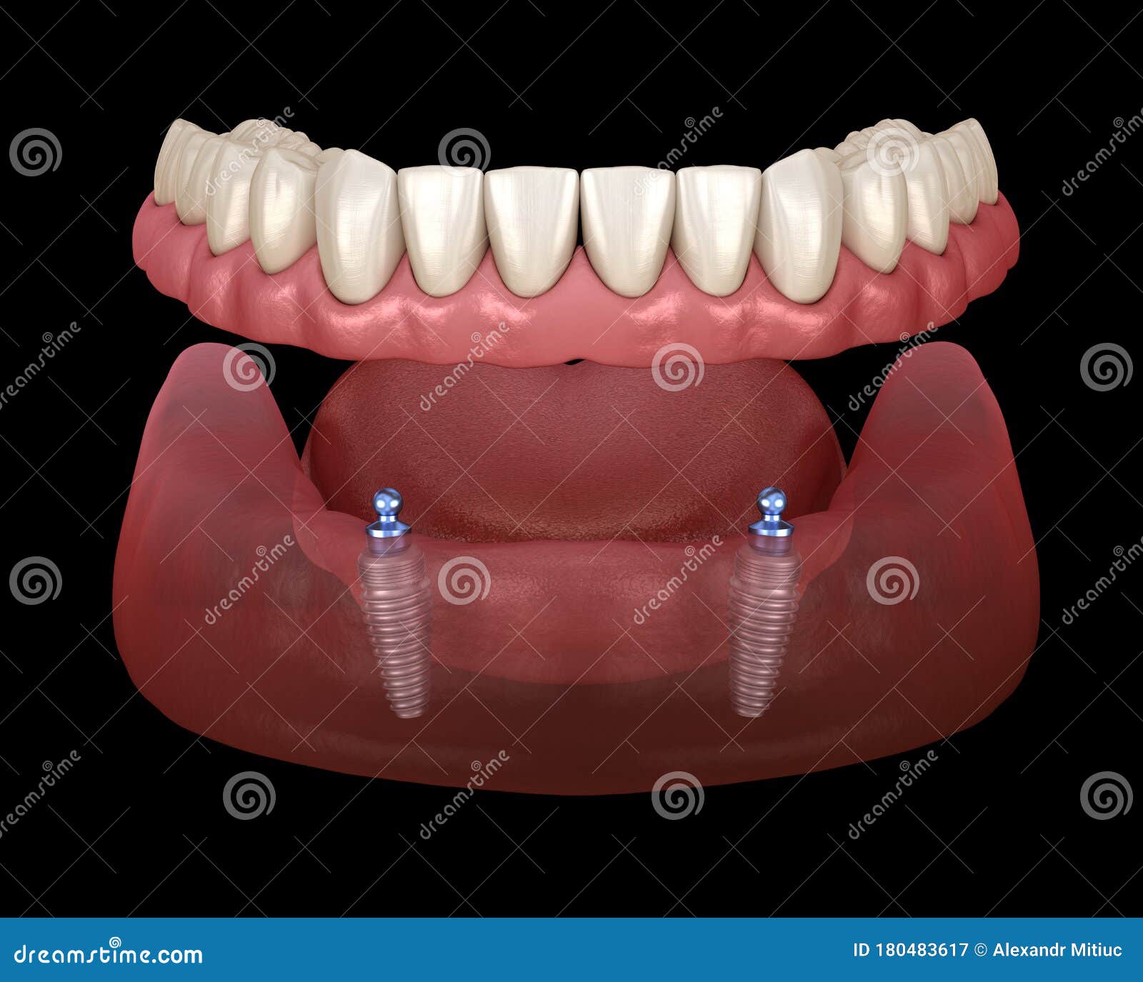 Mandibular Removable Prosthesis All on 2 System Supported by Implants ...