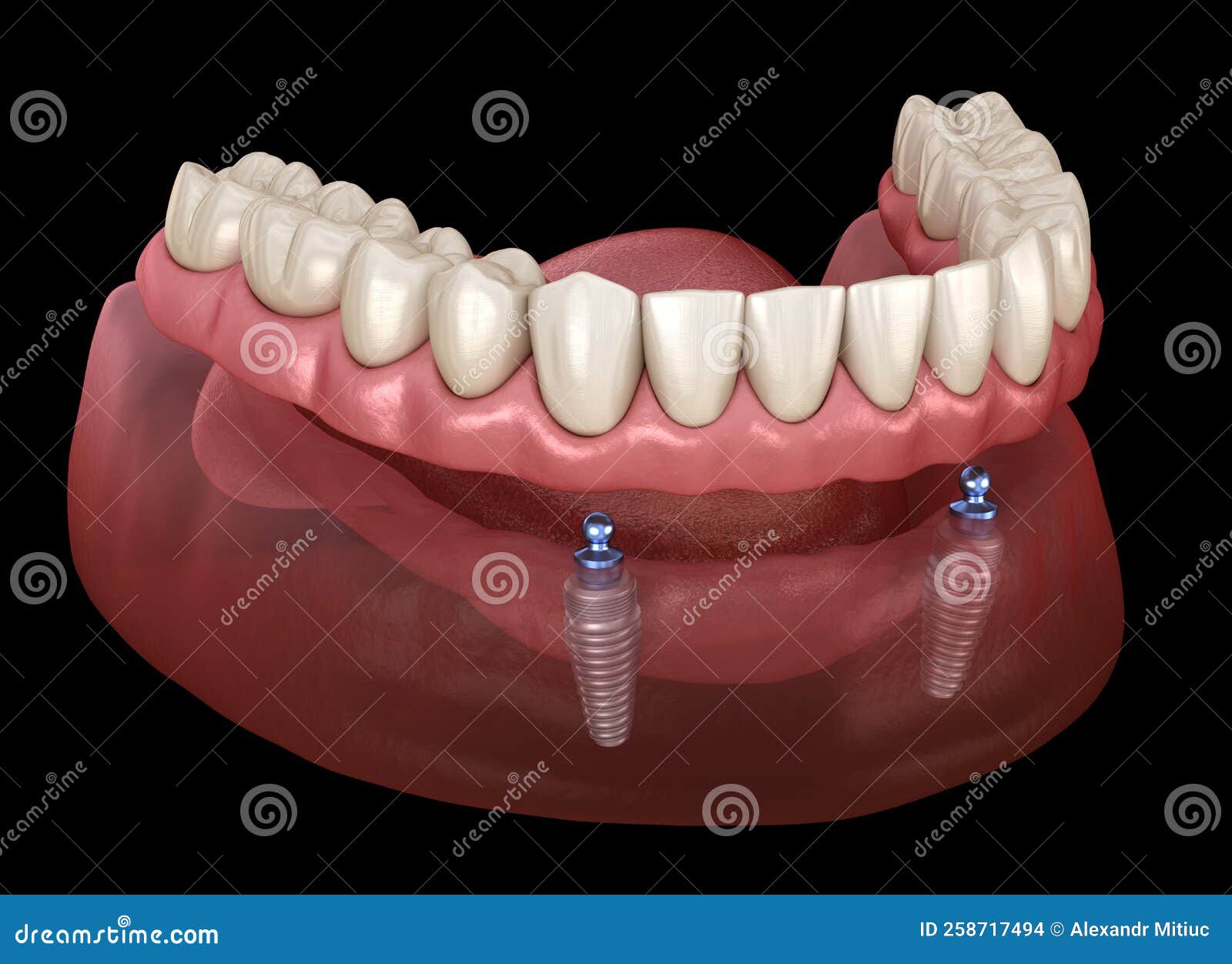 Mandibular Removable Prosthesis All on 2 System Supported by Implants ...
