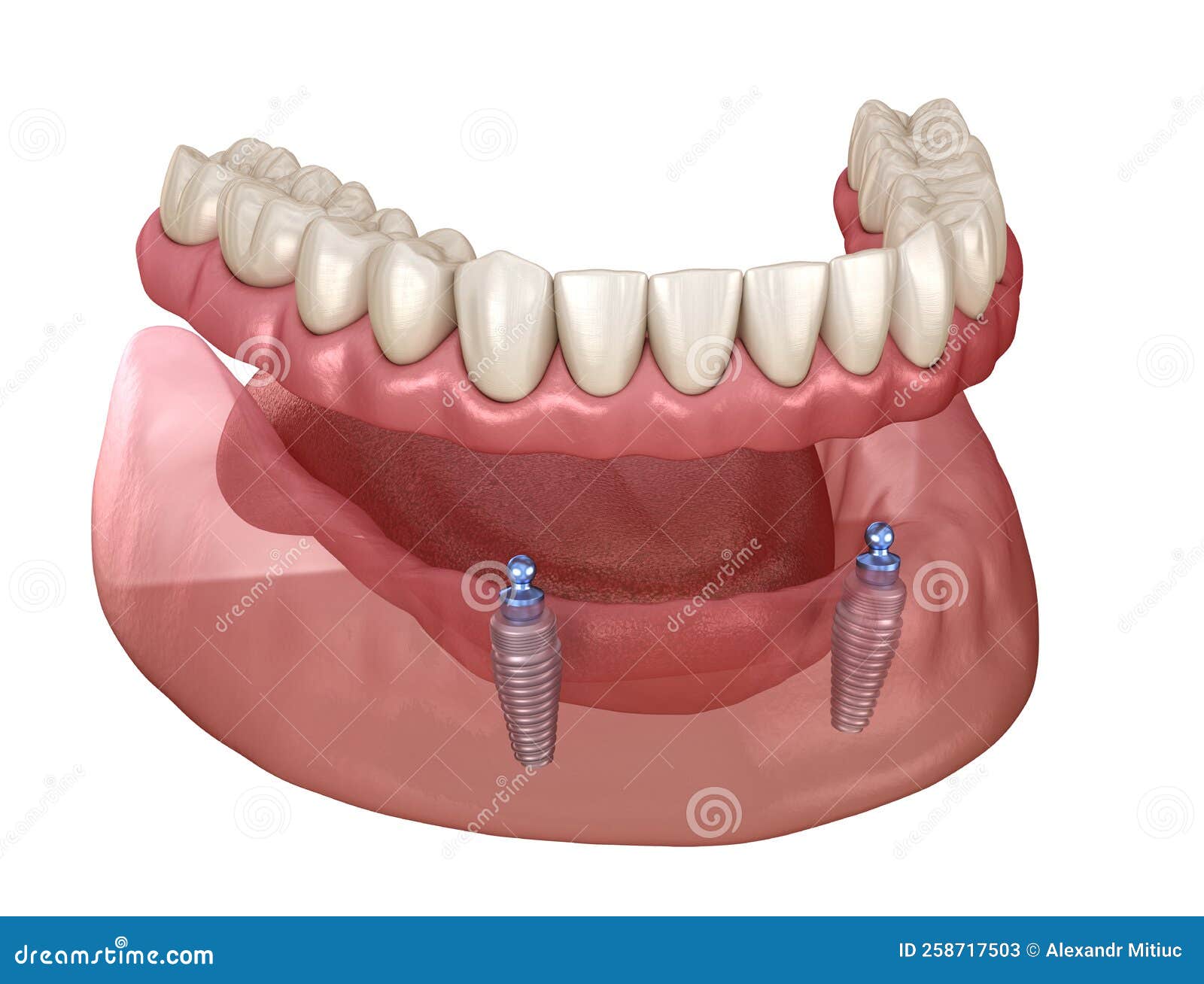 Mandibular Removable Prosthesis All on 2 System Supported by Implants ...